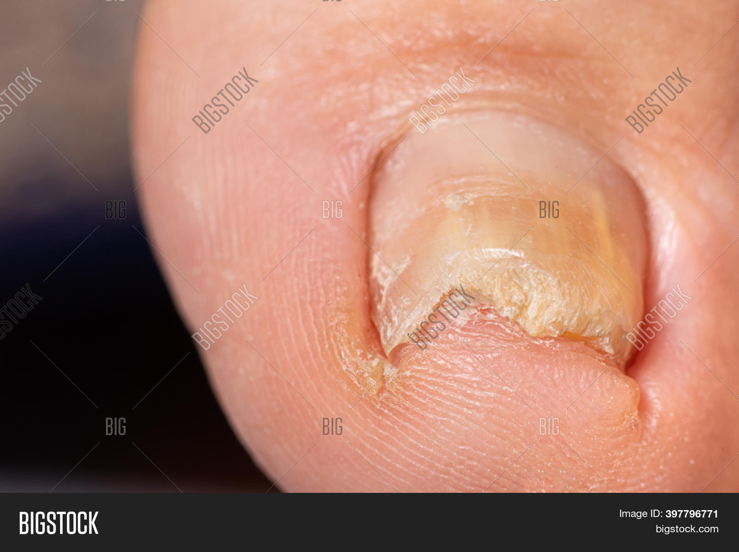 Ingrown Toenail Image & Photo (Free Trial) | Bigstock