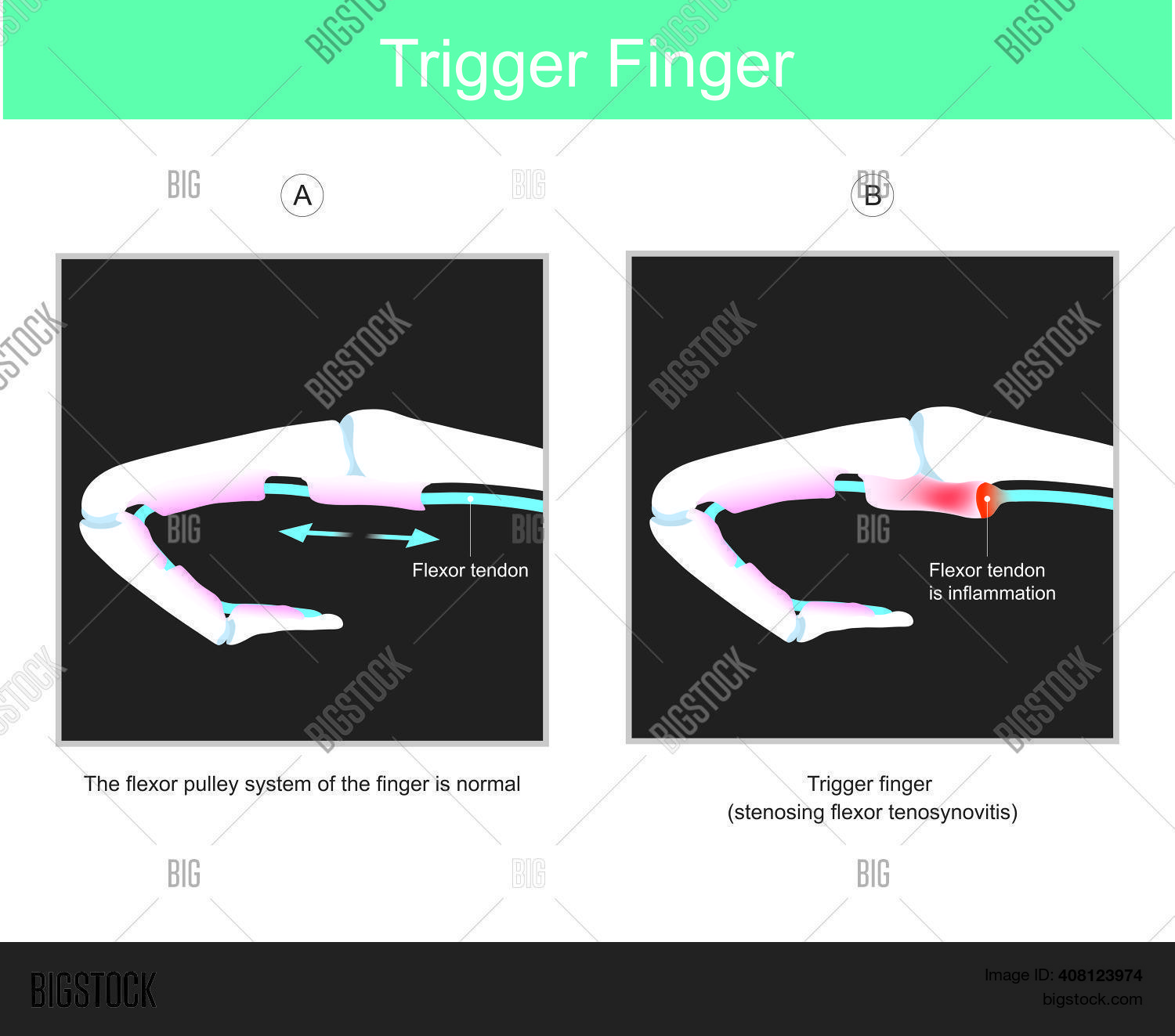 Trigger Finger. Vector & Photo (Free Trial) | Bigstock