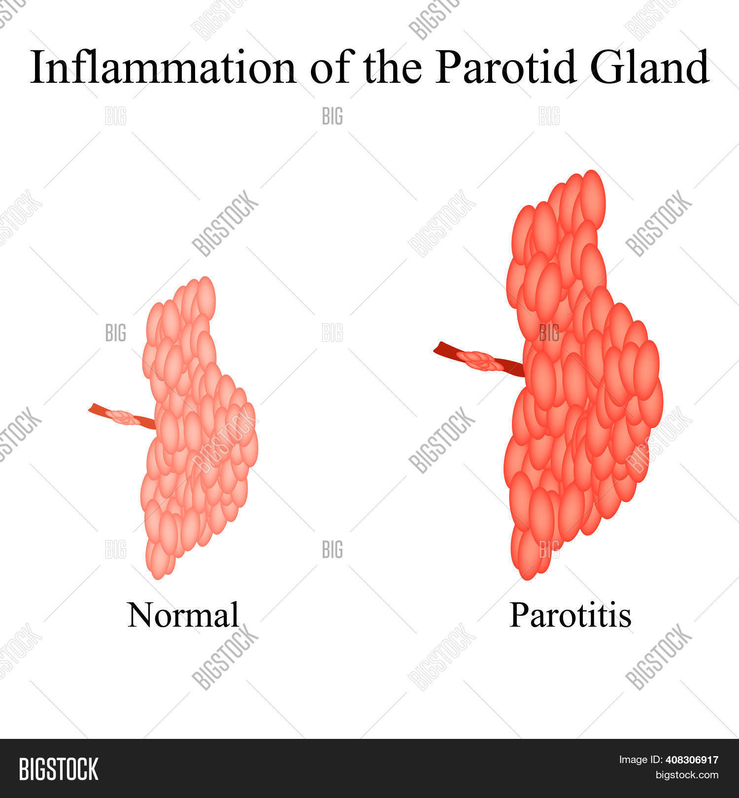 Inflammation Parotid Image & Photo (Free Trial) | Bigstock
