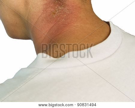 Rash On Neck Isolated Image & Photo (Free Trial) | Bigstock