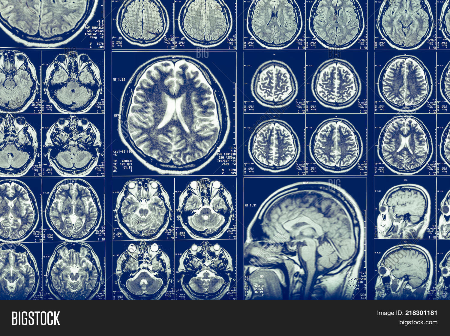 Brain Scan X-ray Mri Image & Photo (Free Trial) | Bigstock