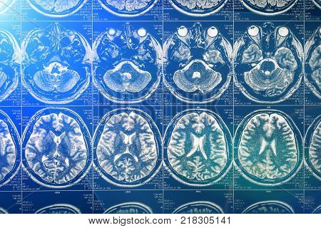 Brain Scan X-ray Mri Image & Photo (Free Trial) | Bigstock