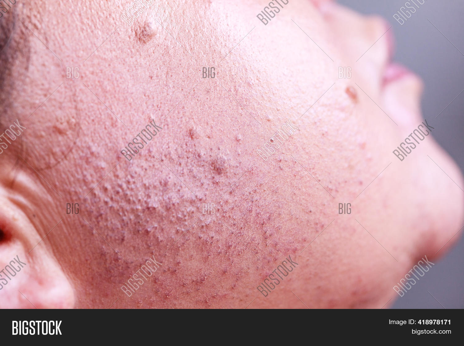 Skin After Laser Image & Photo (Free Trial) | Bigstock