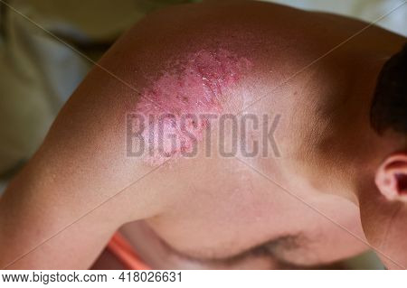 Severe Sunburn On Mans Image & Photo (Free Trial) | Bigstock
