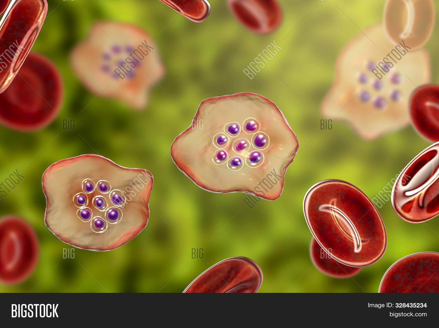 Malaria-infected Red Image & Photo (Free Trial) | Bigstock