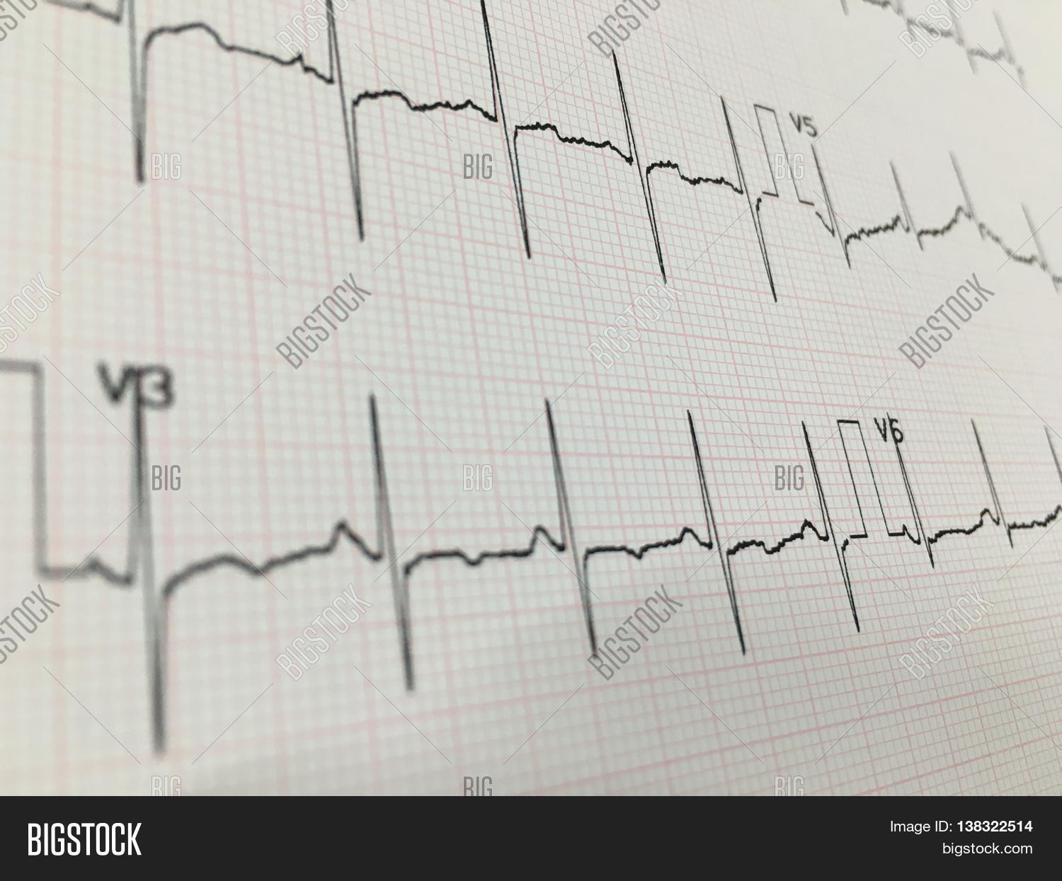 Ecg/Ekg Graph Chest Image & Photo (Free Trial) | Bigstock