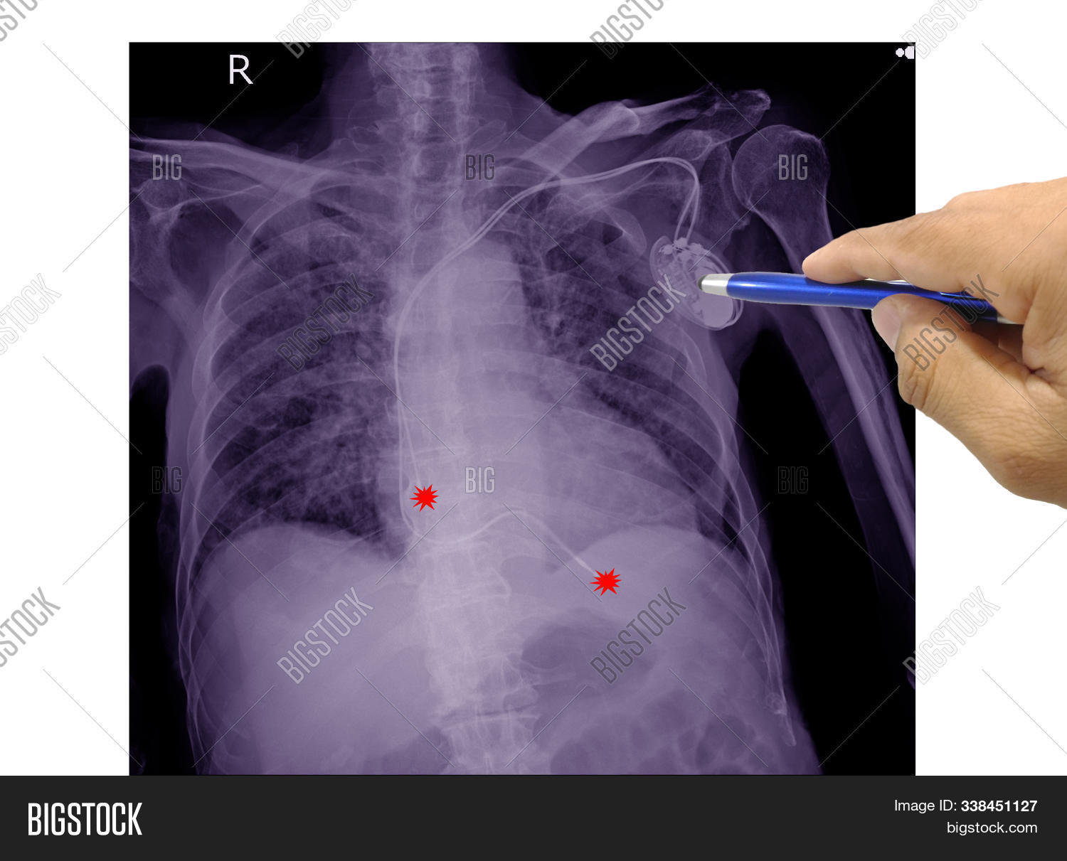 Chest X-ray Film Image & Photo (Free Trial) | Bigstock