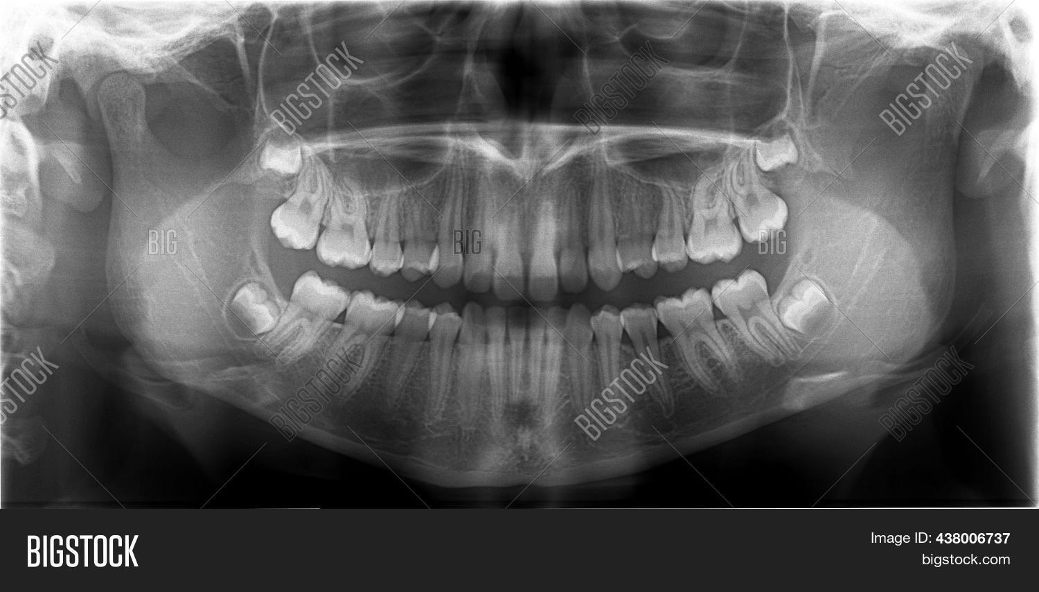 X Ray Growing Teeth Image & Photo (Free Trial) | Bigstock