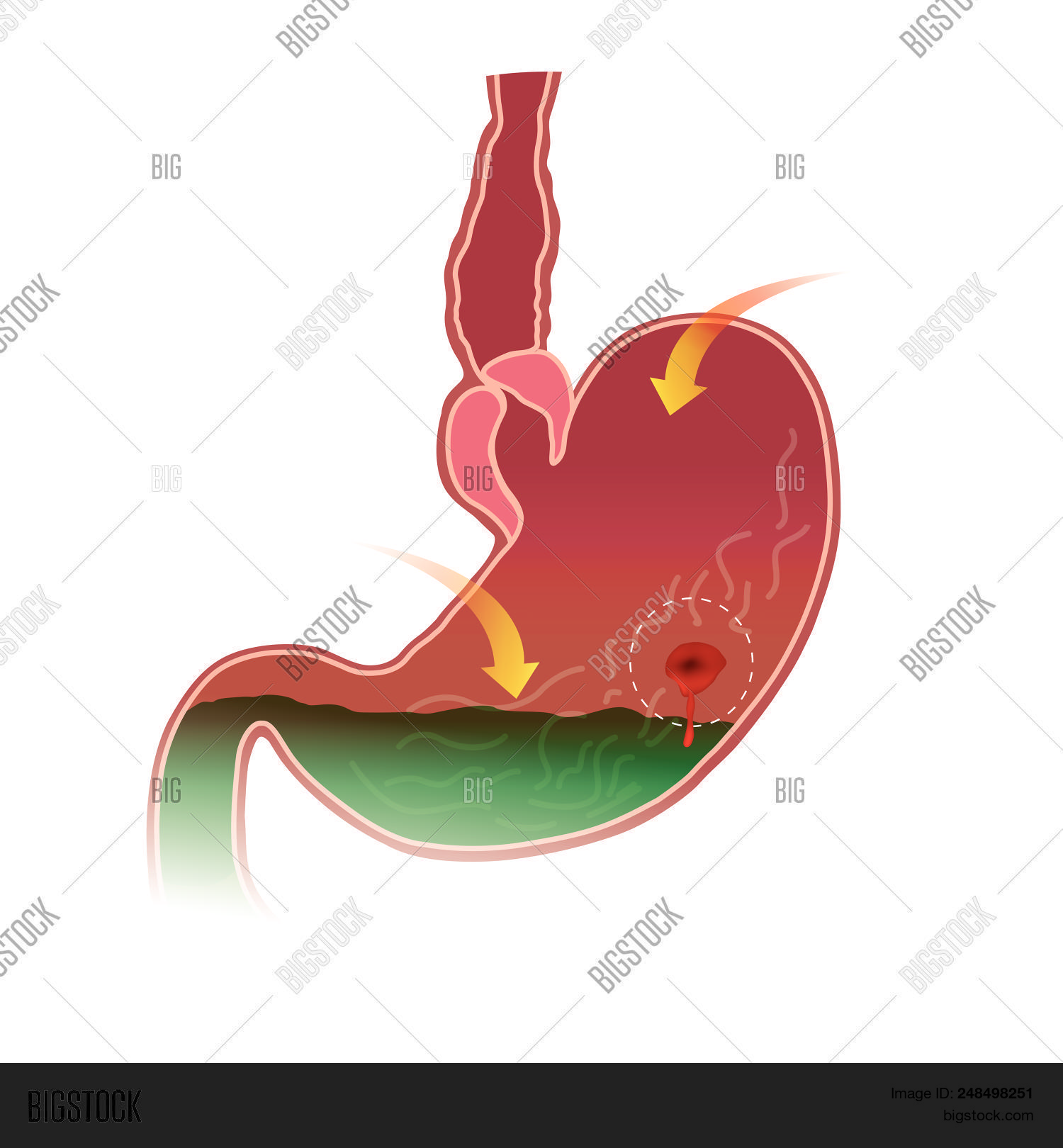Stomach Peptic Ulcer Vector & Photo (Free Trial) | Bigstock