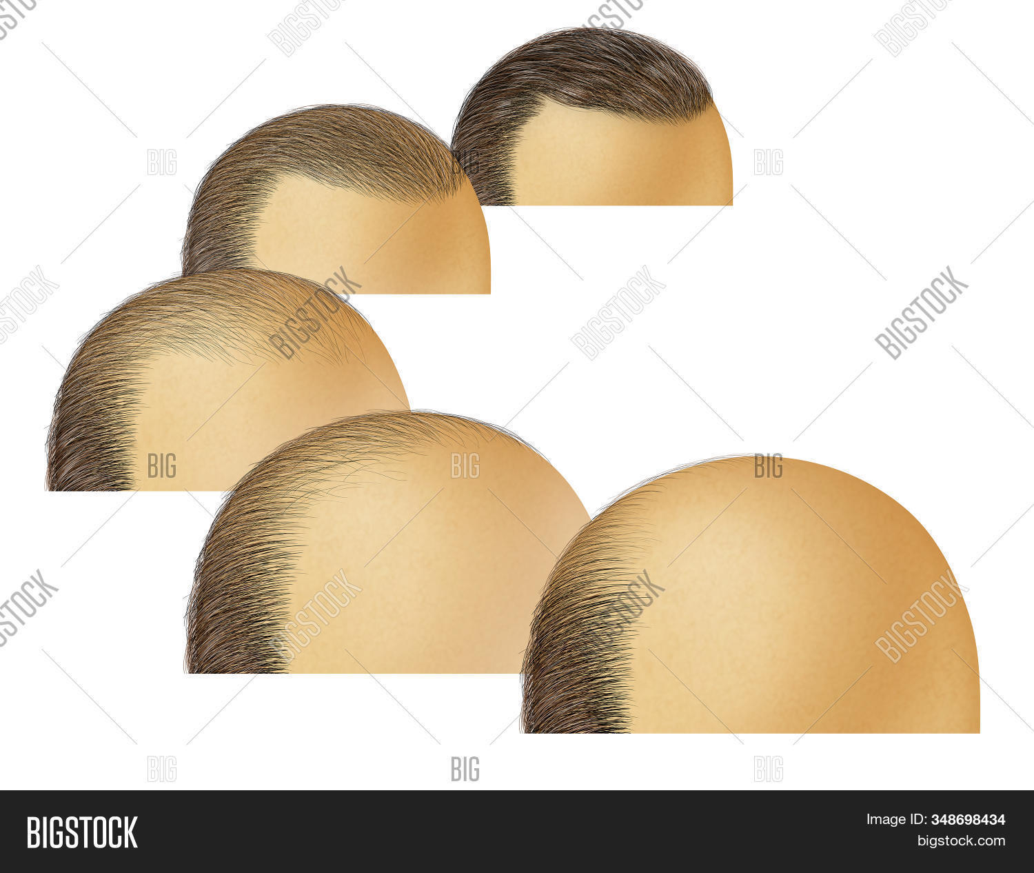 Stages Baldness Bald Image & Photo (Free Trial) | Bigstock