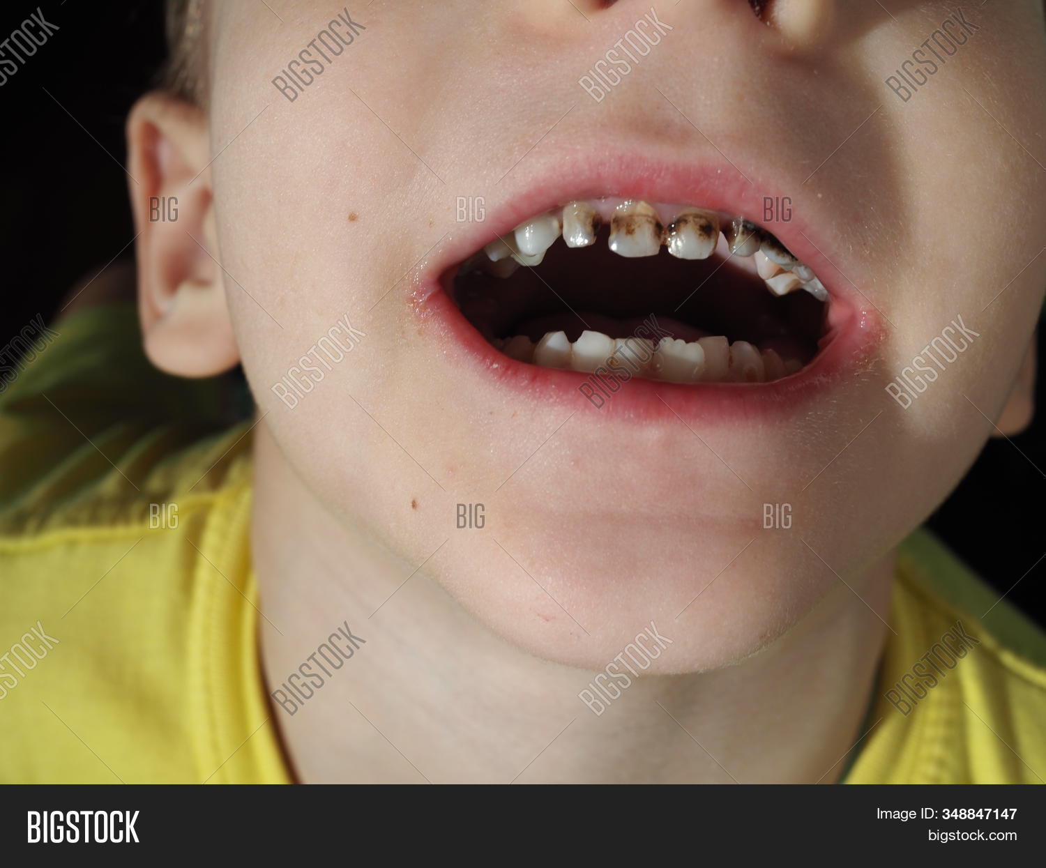 Abnormal Boy Tooth. Image & Photo (Free Trial) | Bigstock