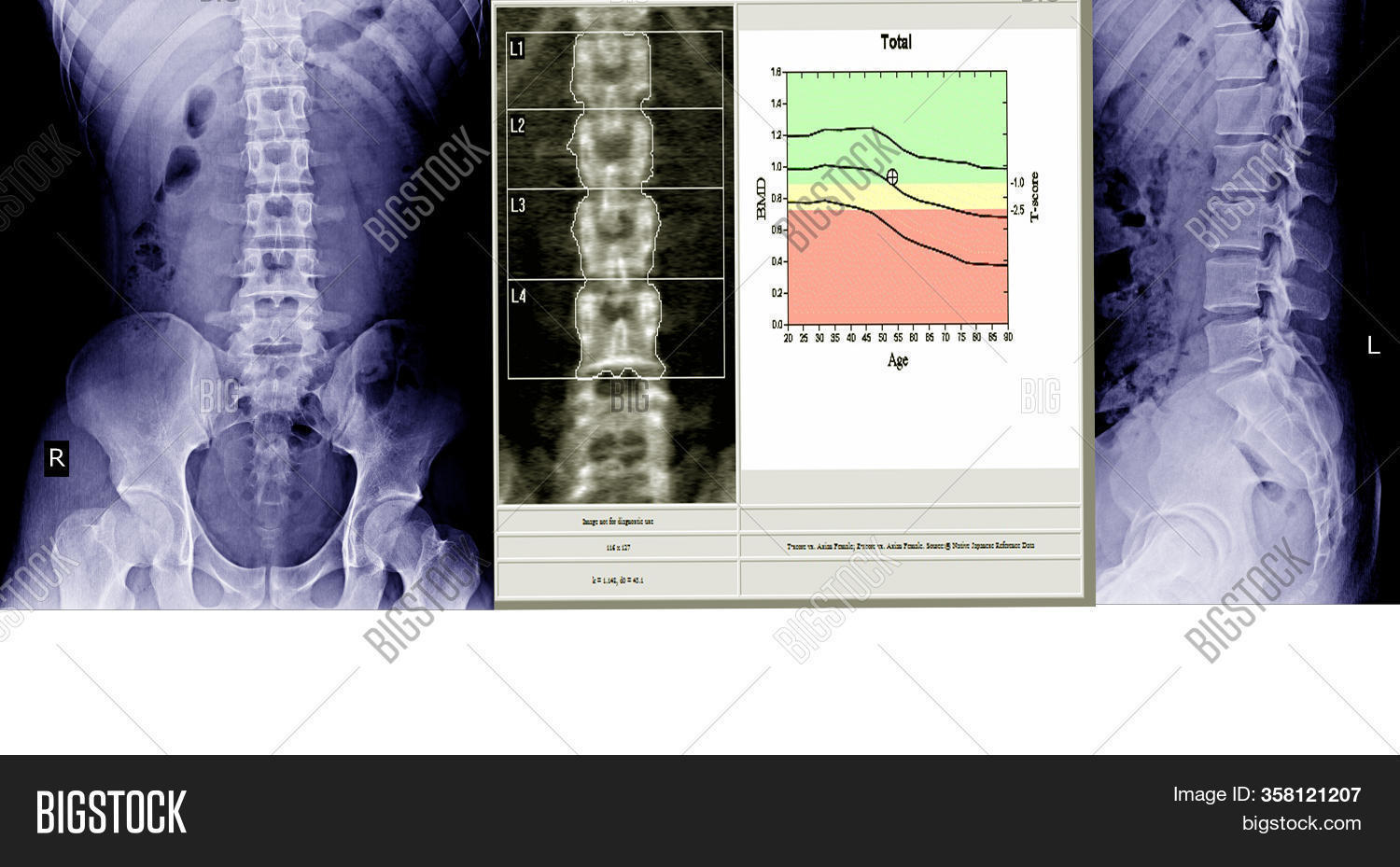 X-ray Lumbo-sacral Image & Photo (Free Trial) | Bigstock
