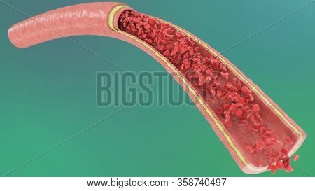 Cross Section Artery Image & Photo (Free Trial) | Bigstock