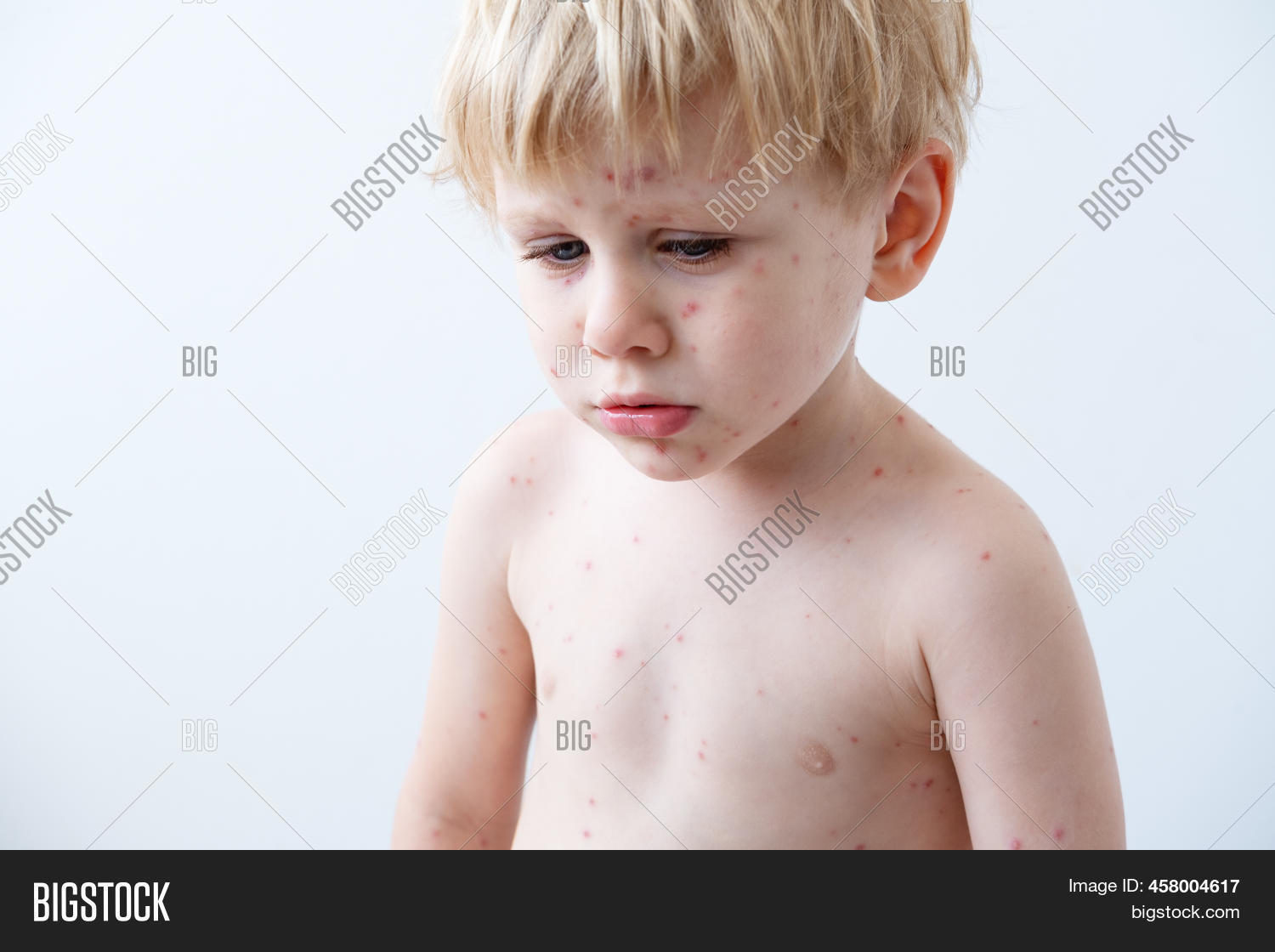 Chickenpox Disease, Image & Photo (Free Trial) | Bigstock