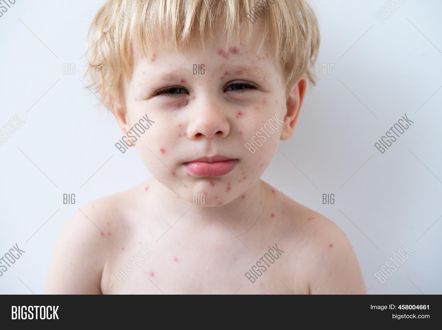 Chickenpox Disease, Image & Photo (Free Trial) | Bigstock