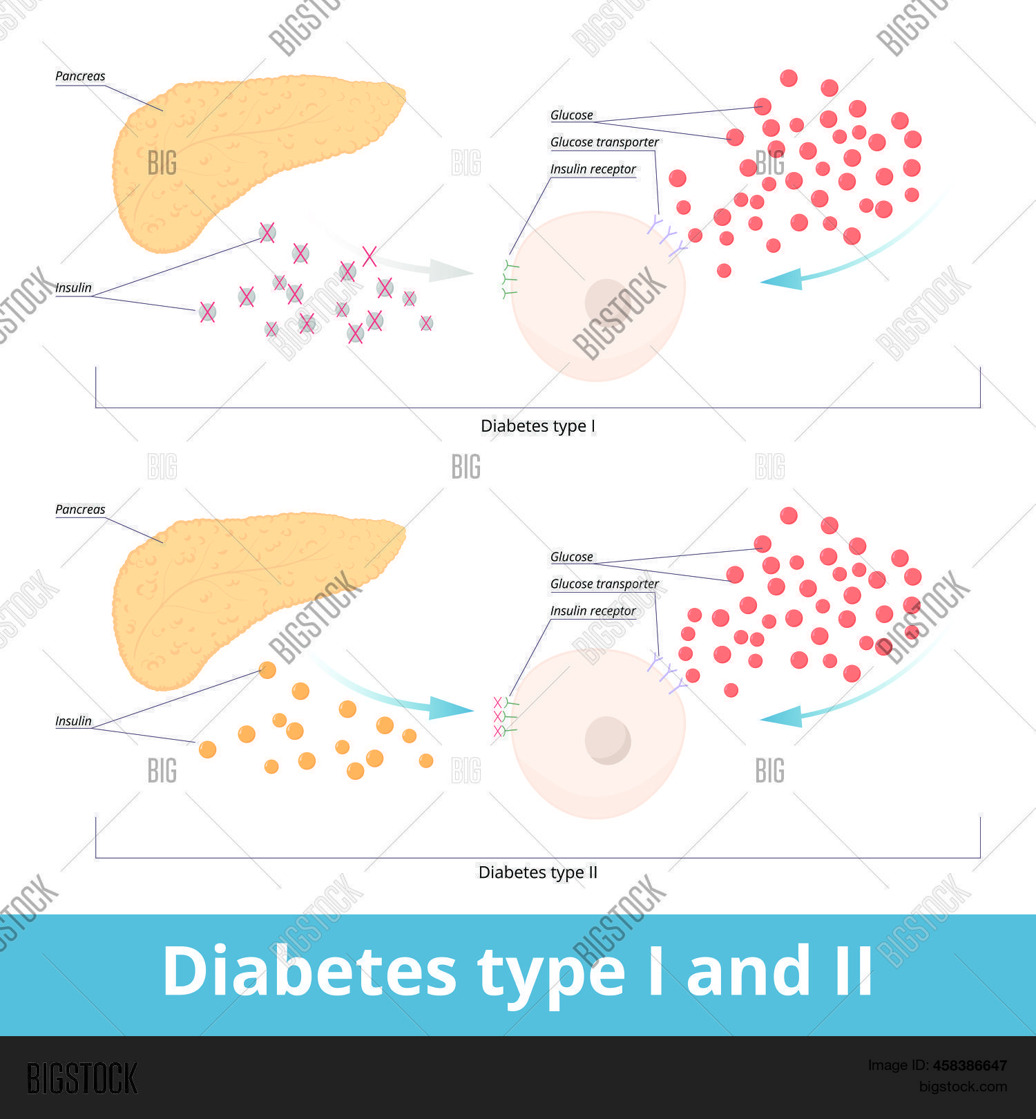 Diabetes 矢量图和照片（免费试用） | Bigstock
