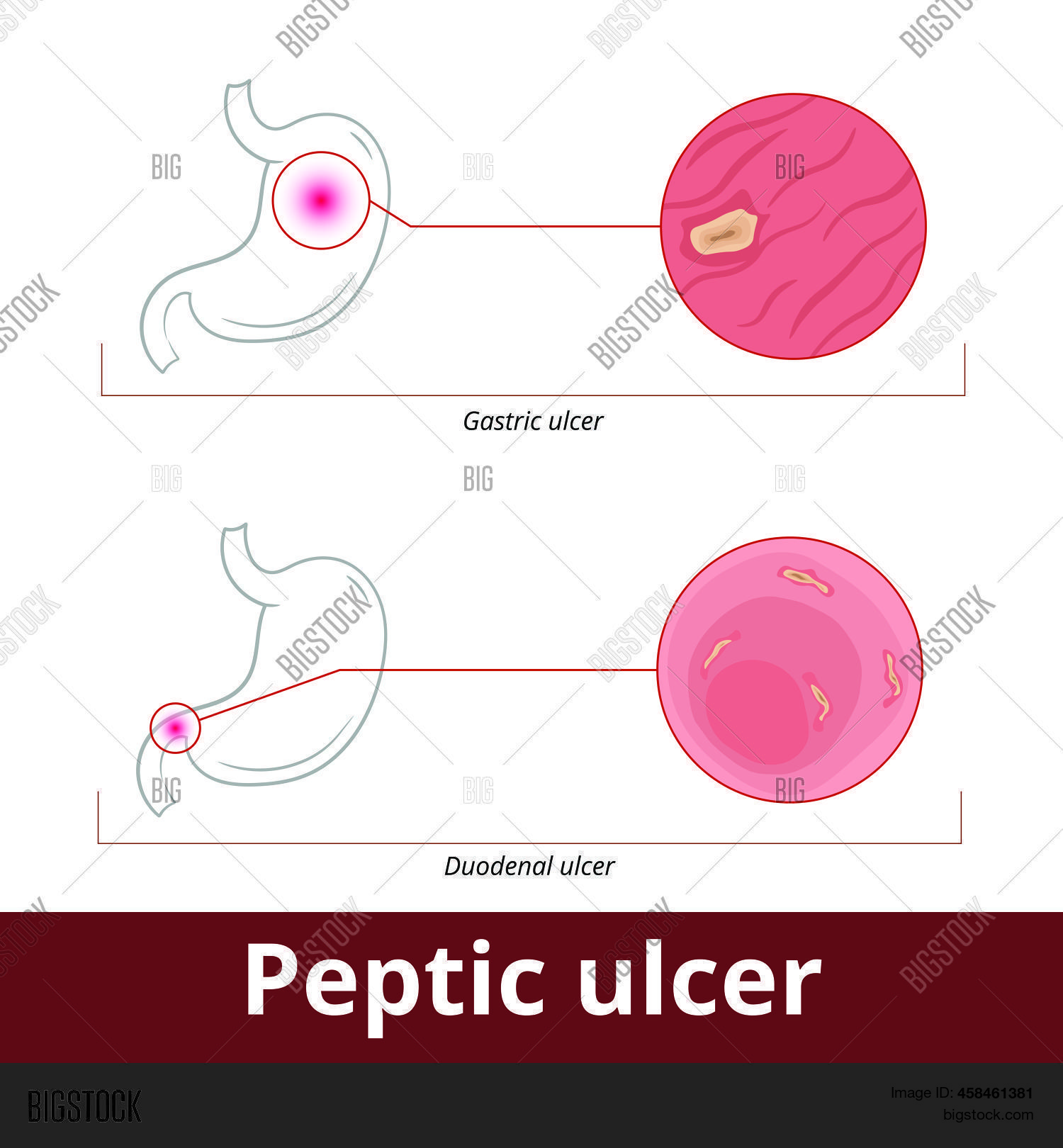 Peptic Ulcer. Vector & Photo (Free Trial) | Bigstock