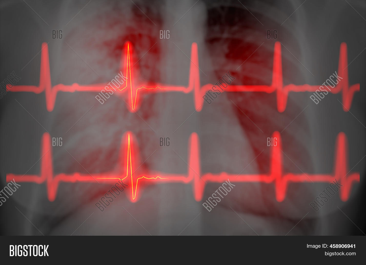 Chest X-ray Ekg 3D Image & Photo (Free Trial) | Bigstock