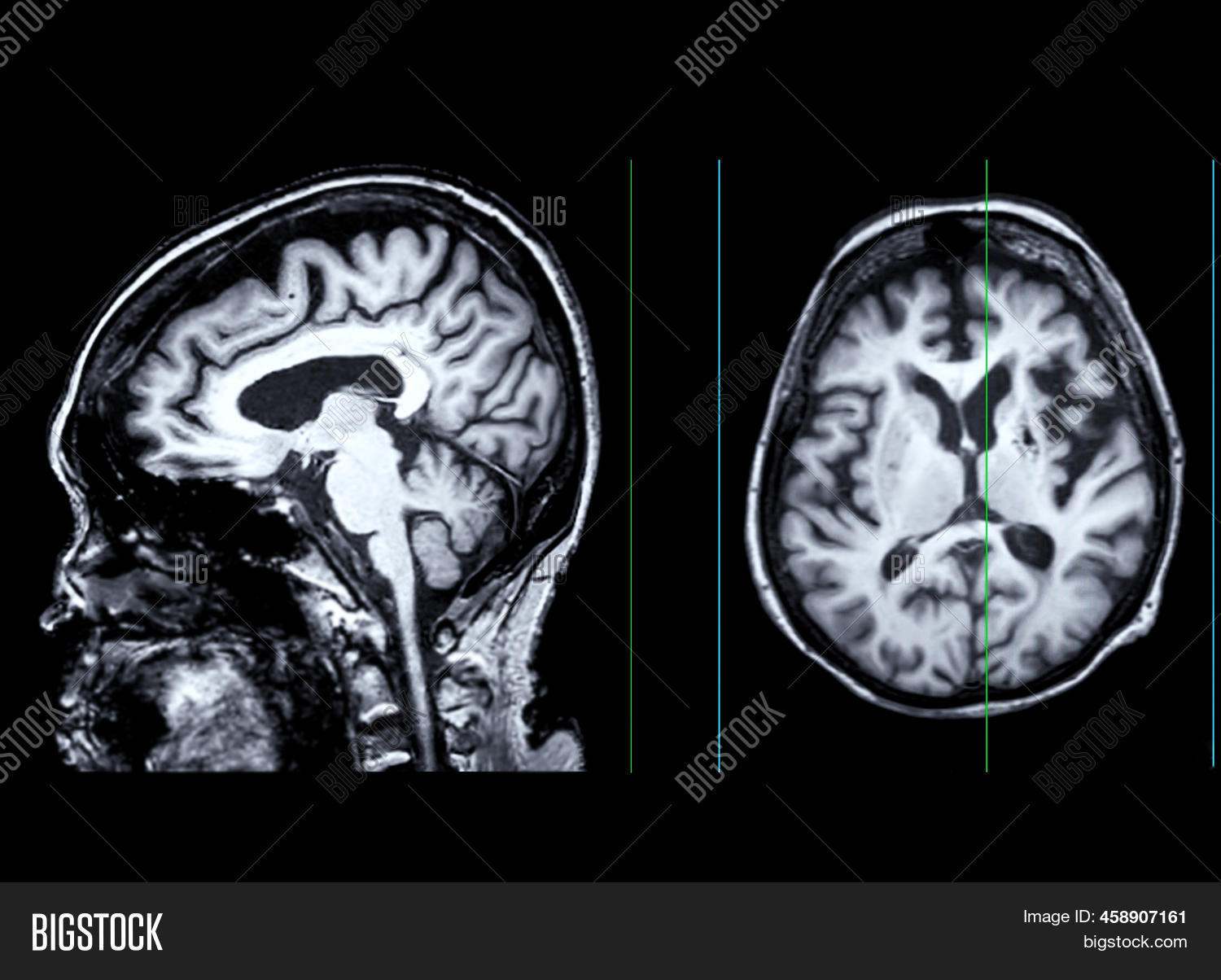 Mri Brain Sagittal Image & Photo (Free Trial) | Bigstock