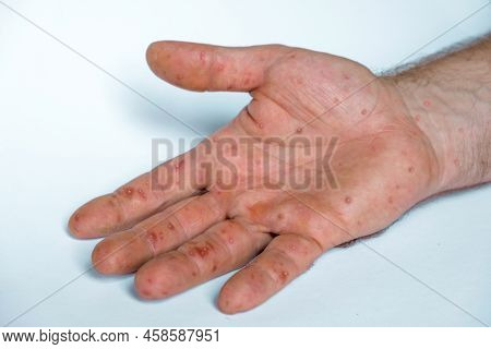 Male Hands Monkeypox Image & Photo (Free Trial) | Bigstock