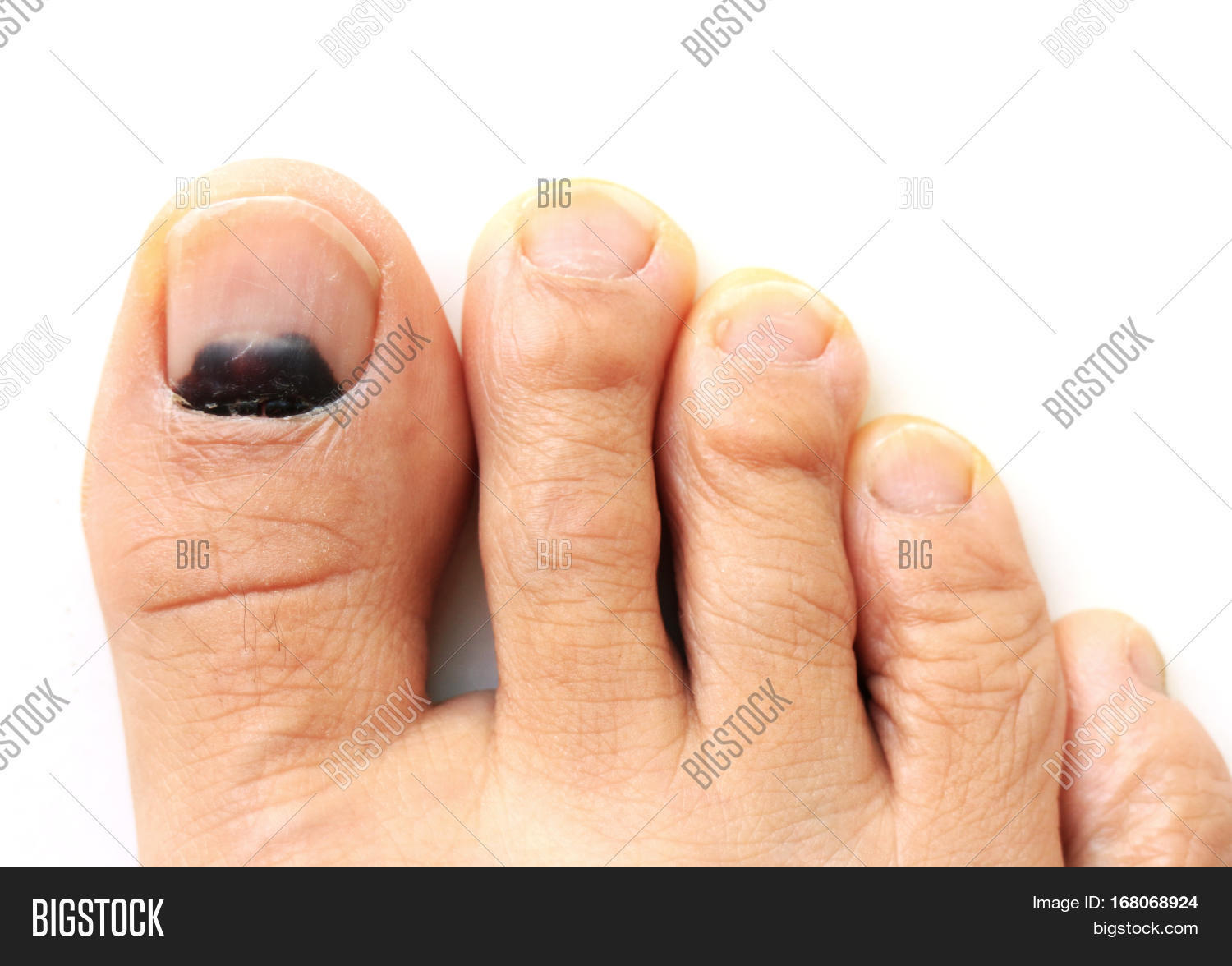 Bruise On Big Toe Nail Image & Photo (Free Trial) | Bigstock