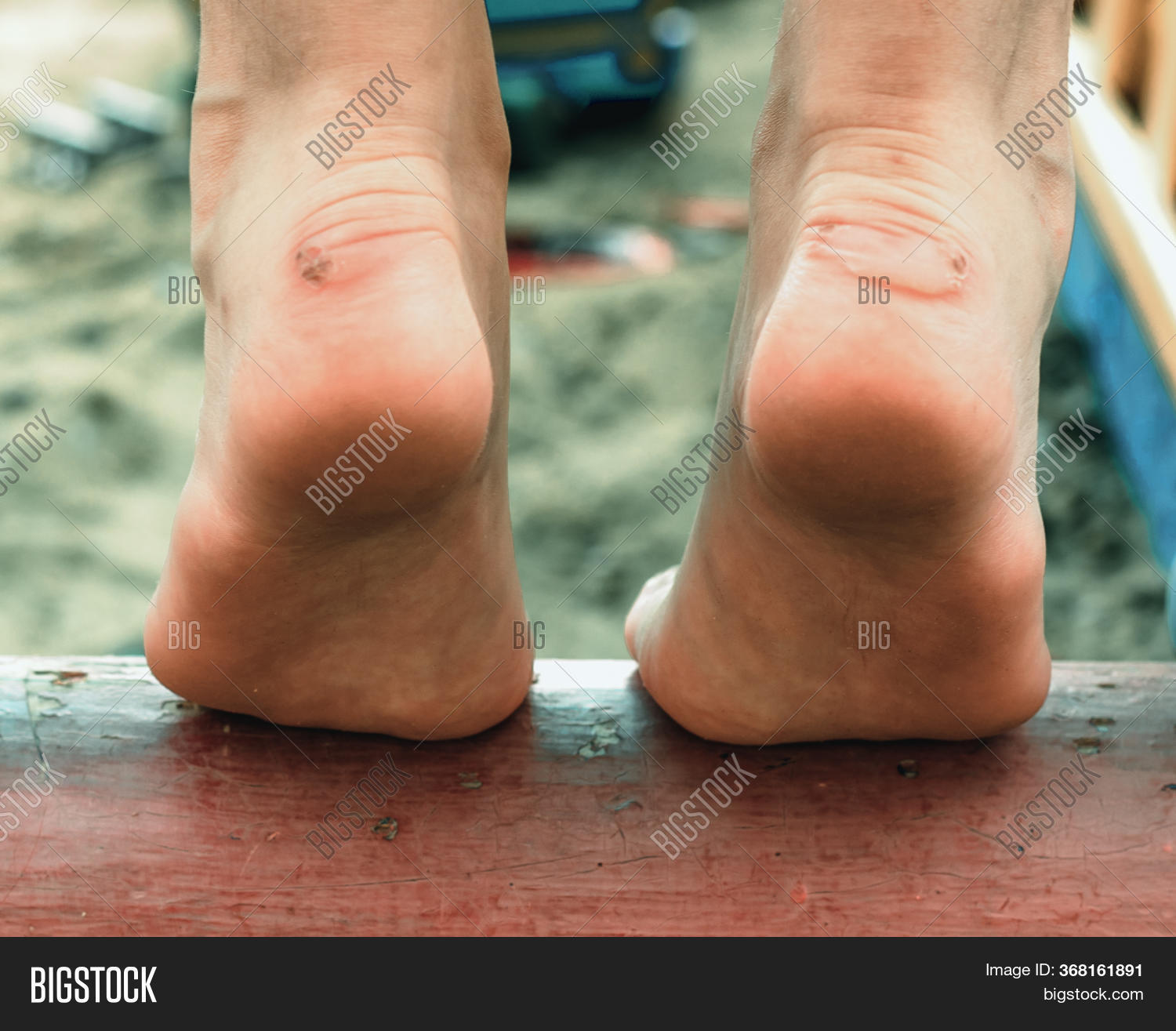 Girl Calluses On Her Image & Photo (Free Trial) | Bigstock
