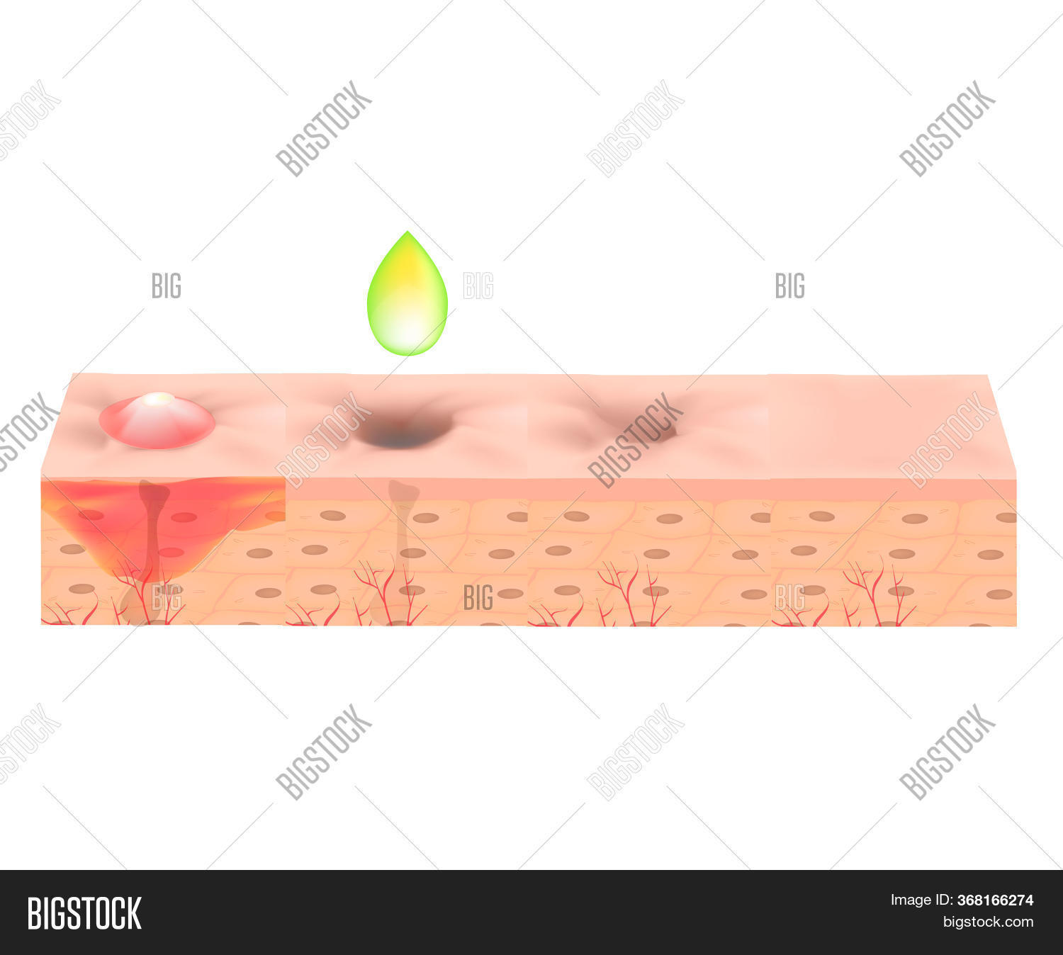 Atrophic Scars. Acne Image & Photo (Free Trial) | Bigstock