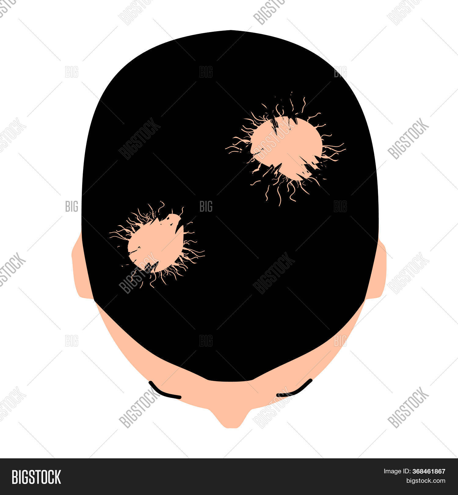 Alopecia Hair. Image & Photo (Free Trial) | Bigstock