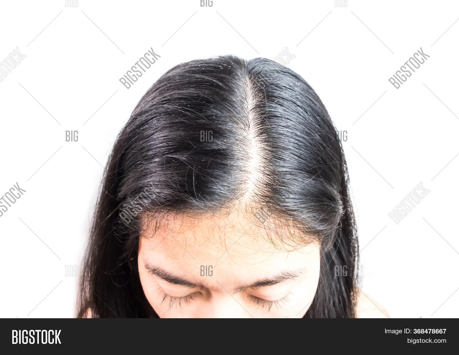 Women Head Dandruff Image & Photo (Free Trial) | Bigstock