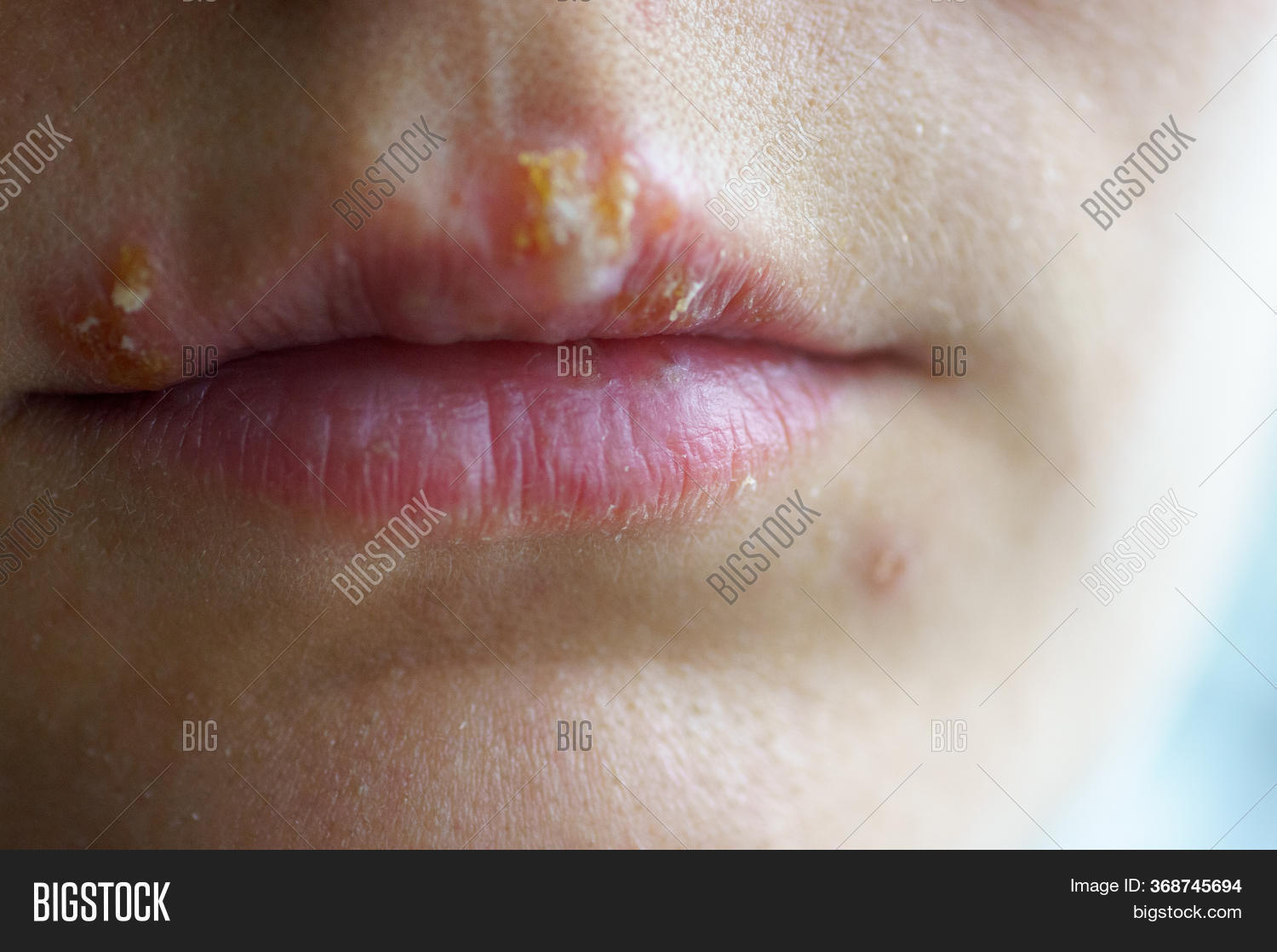 Herpes Disease On Lips Image & Photo (Free Trial) | Bigstock