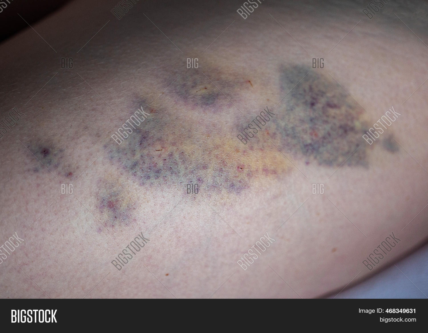 Bruises On Skin Image & Photo (Free Trial) | Bigstock