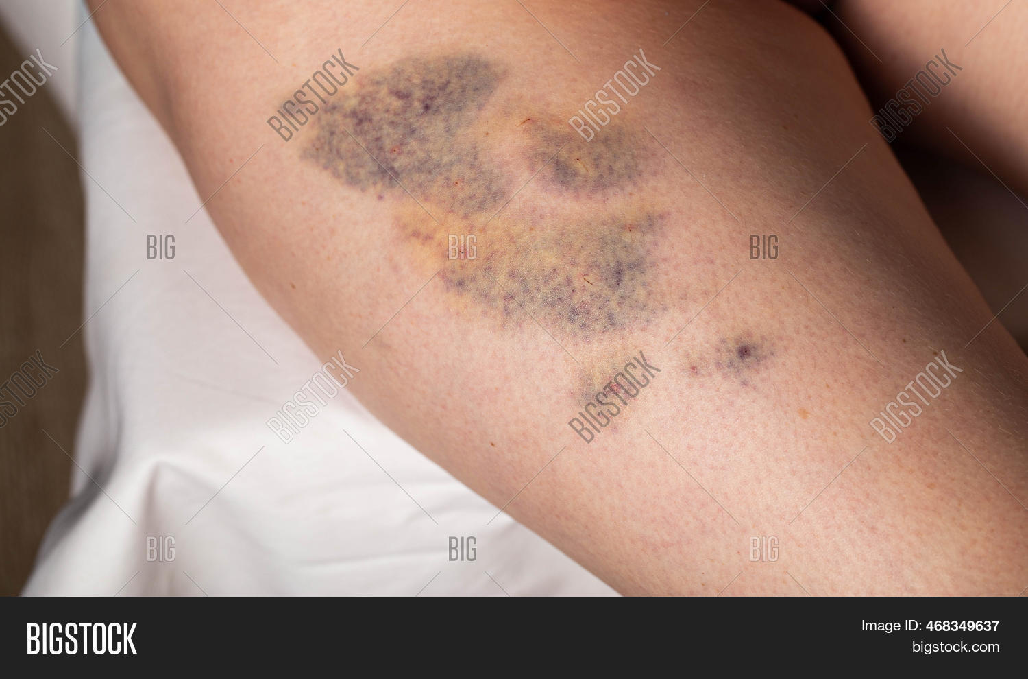 Bruises On Leg Female Image & Photo (Free Trial) | Bigstock