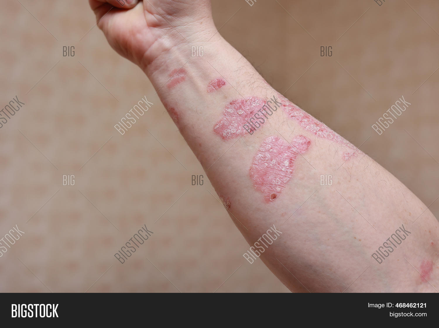 Man Sick Arm, Dry Image & Photo (Free Trial) | Bigstock