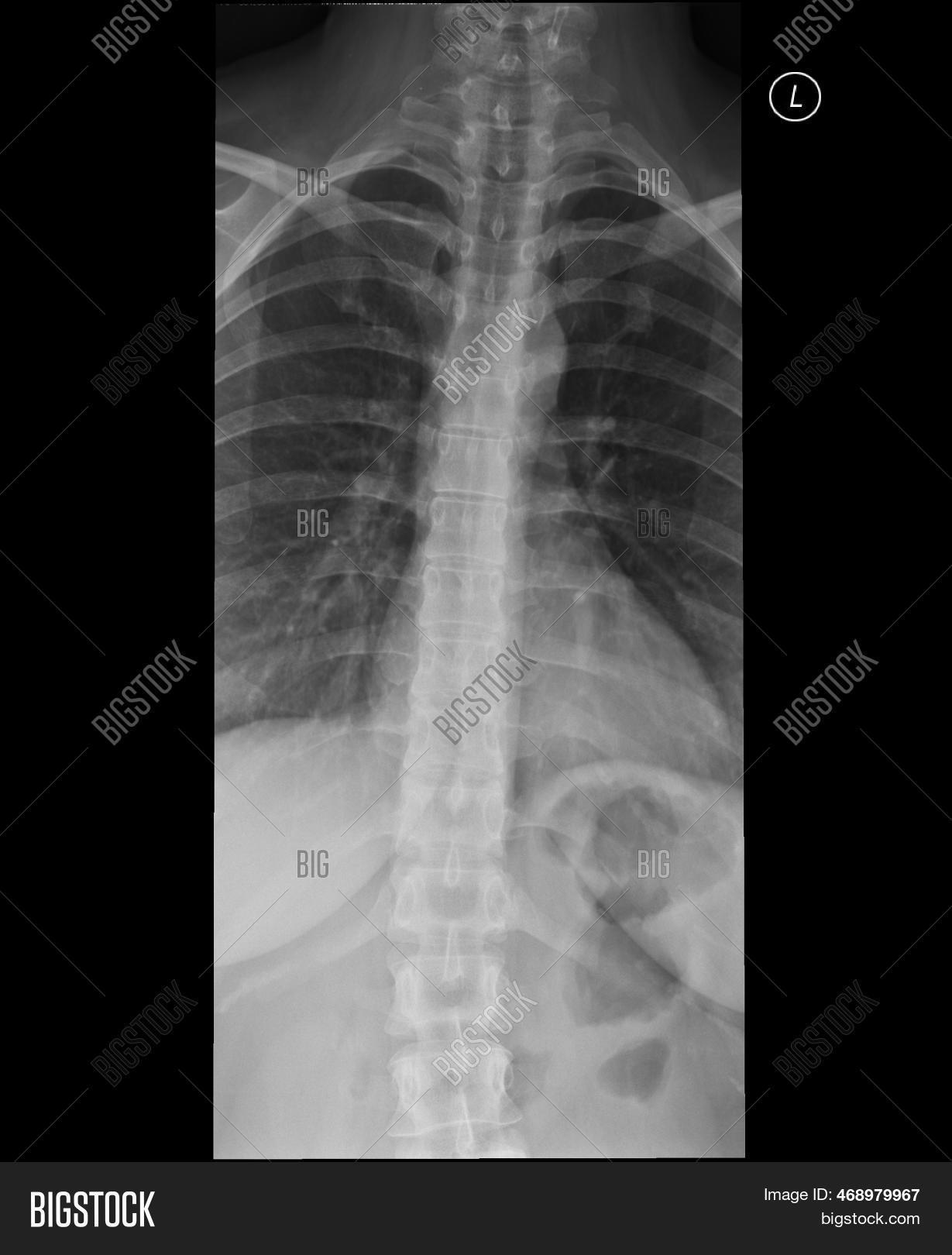 Thoracic Spine X-ray. Image & Photo (Free Trial) | Bigstock