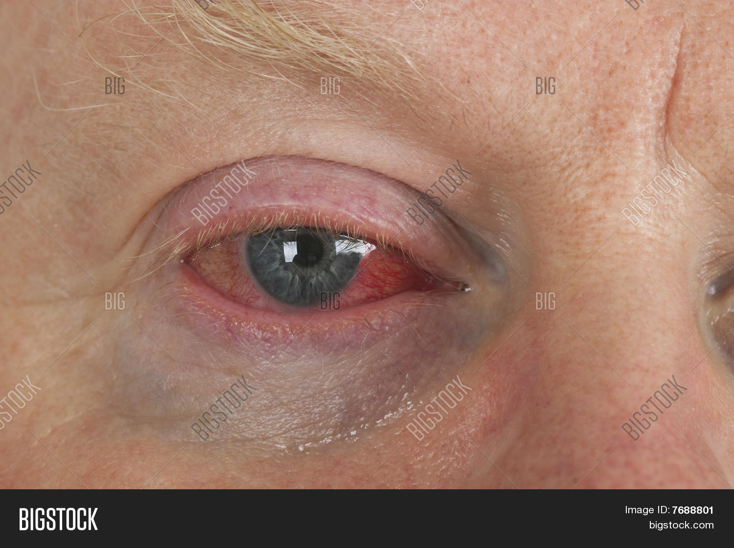 Bloodshot Eye Image & Photo (Free Trial) | Bigstock
