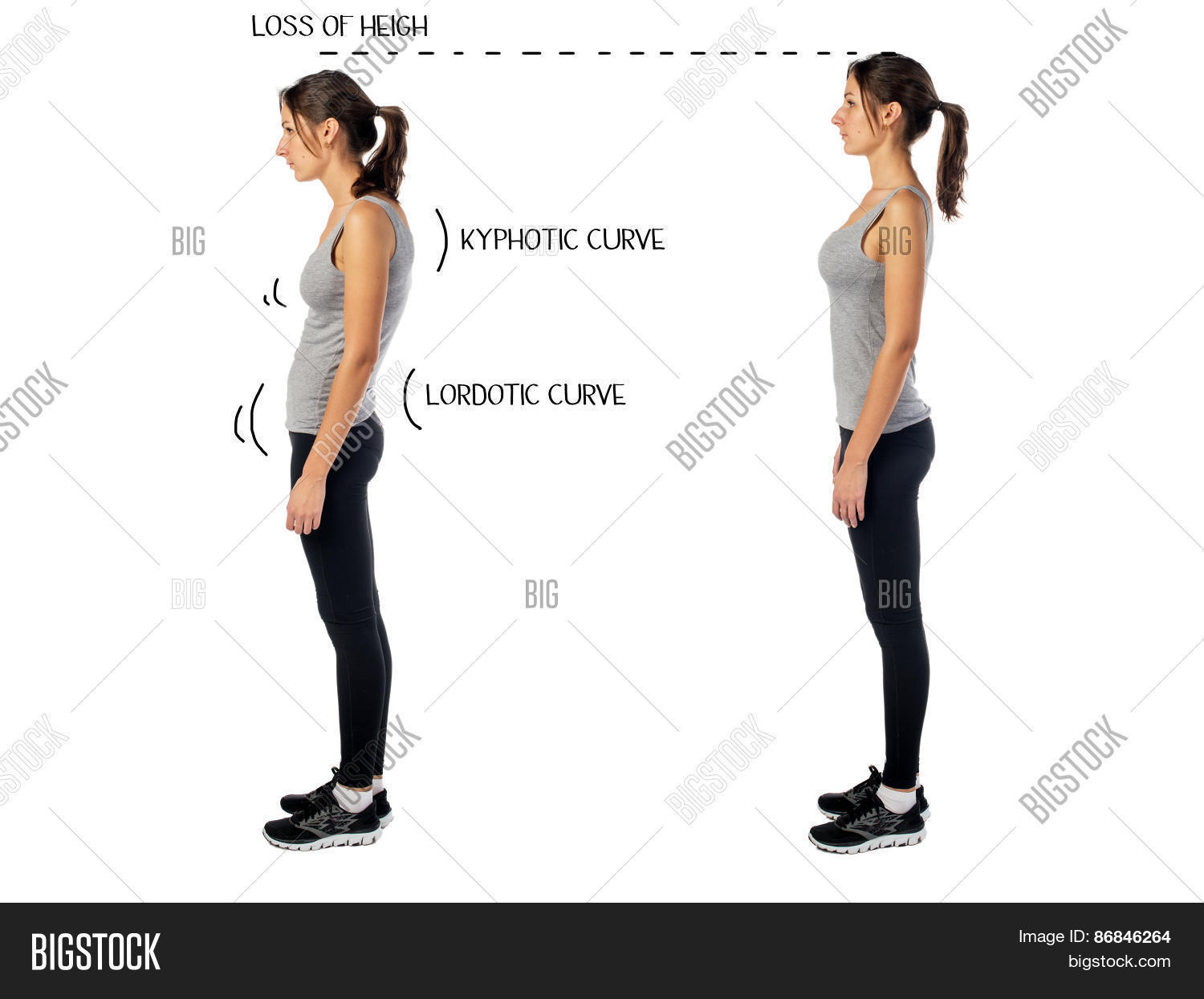 Woman Impaired Posture Image & Photo (Free Trial) | Bigstock