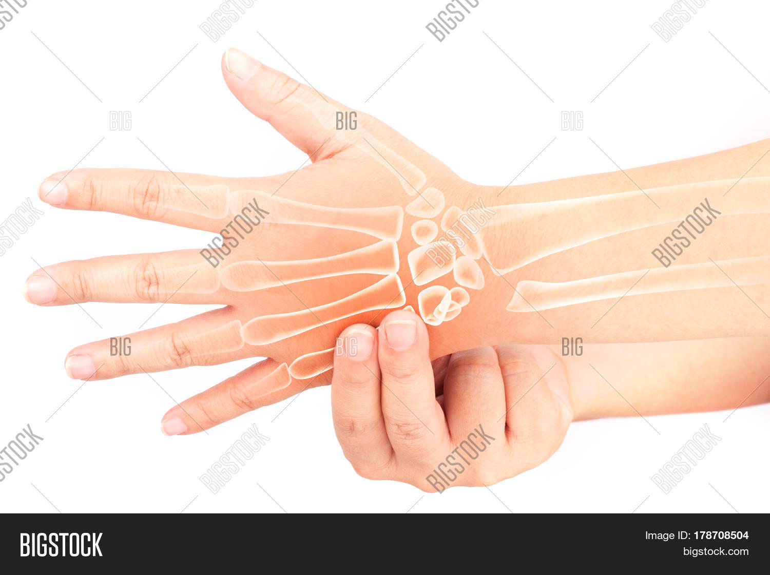 Hand Bones Injury Image & Photo (Free Trial) | Bigstock