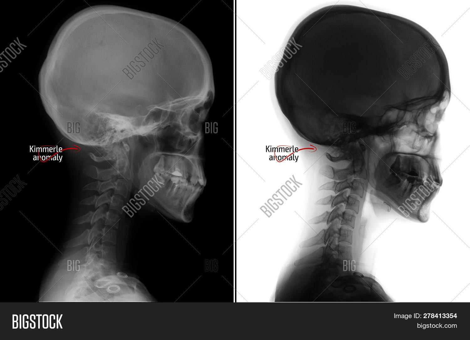 X-ray Cervical Spine. Image & Photo (Free Trial) | Bigstock