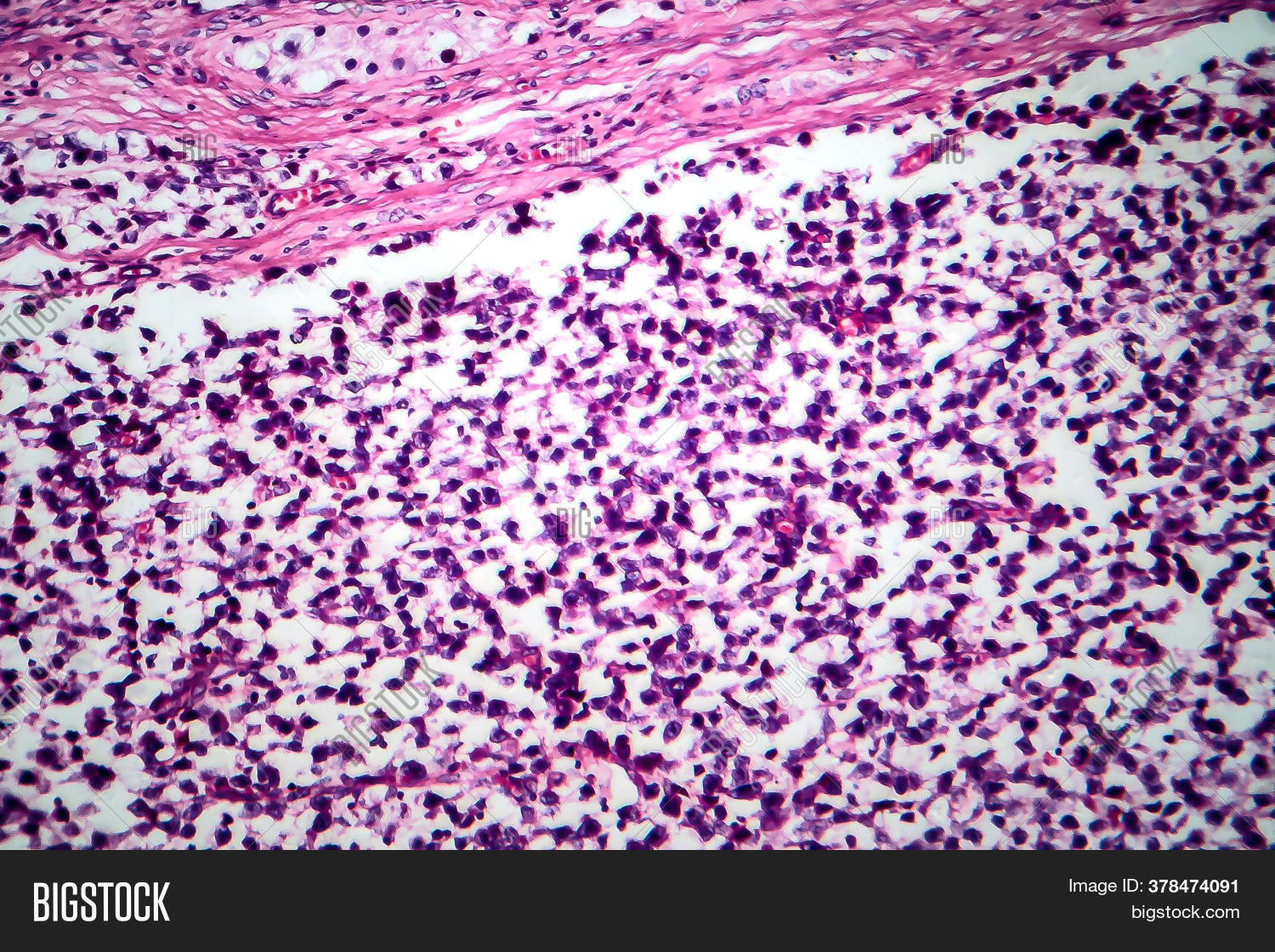 Testicular Seminoma, Image & Photo (Free Trial) | Bigstock