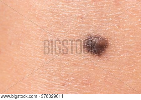 Mole Birthmark Nevus Image & Photo (Free Trial) | Bigstock
