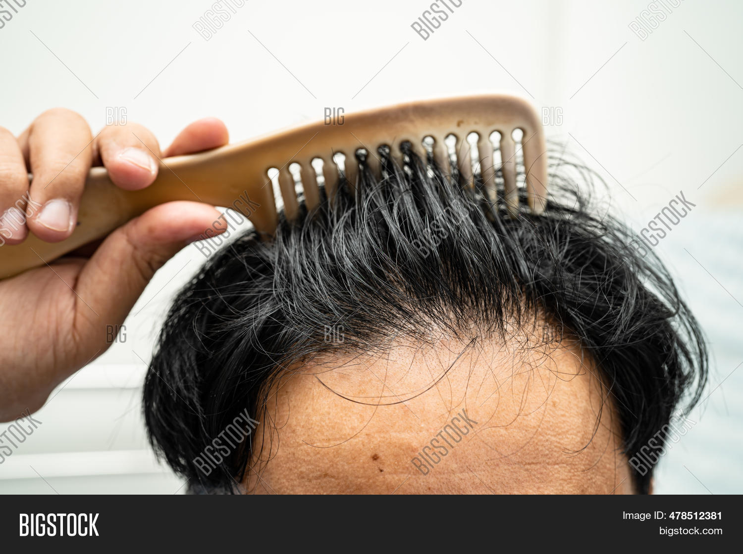 Bald Front Head Begin Image & Photo (Free Trial) | Bigstock