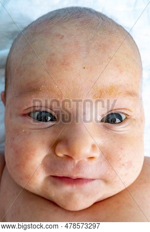 Baby Allergy Skin. Image & Photo (Free Trial) | Bigstock