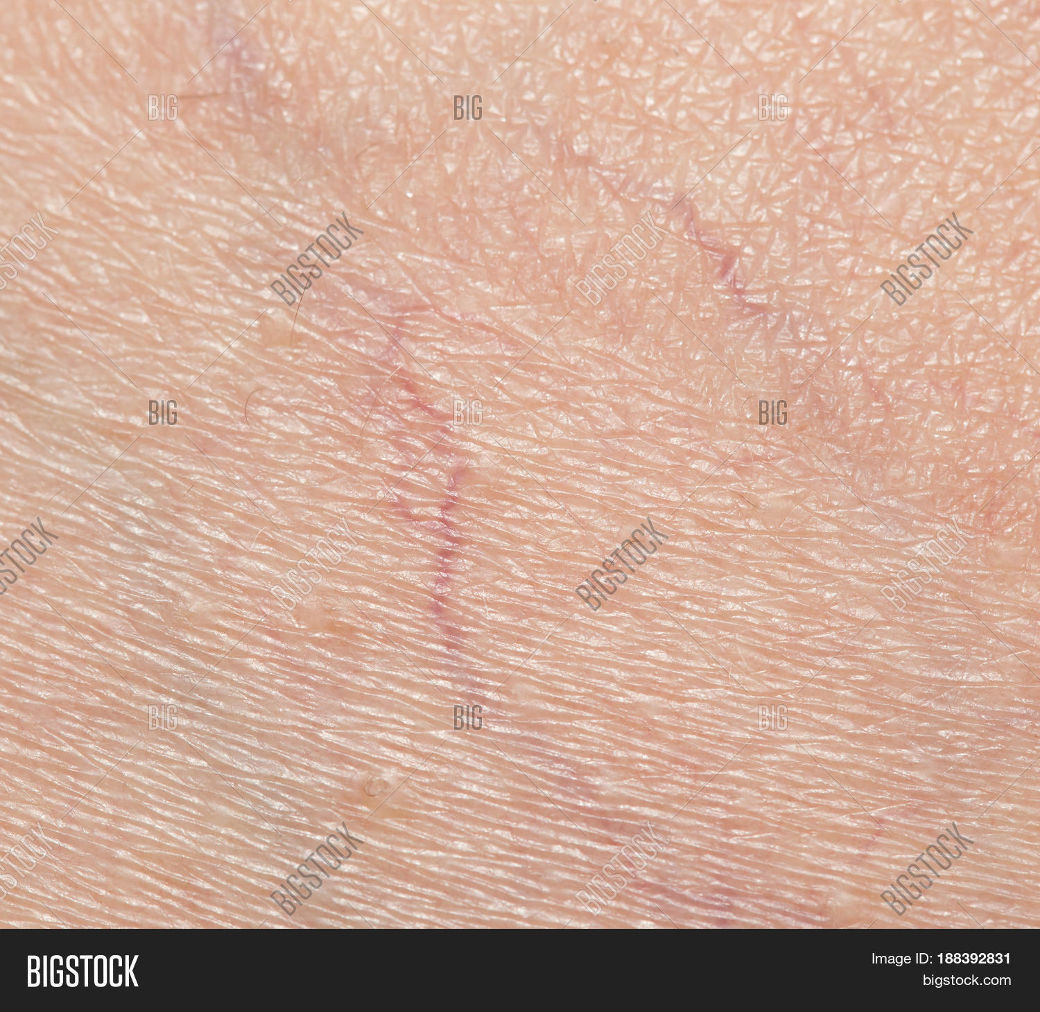 Veins On Skin. Close Image & Photo (Free Trial) | Bigstock