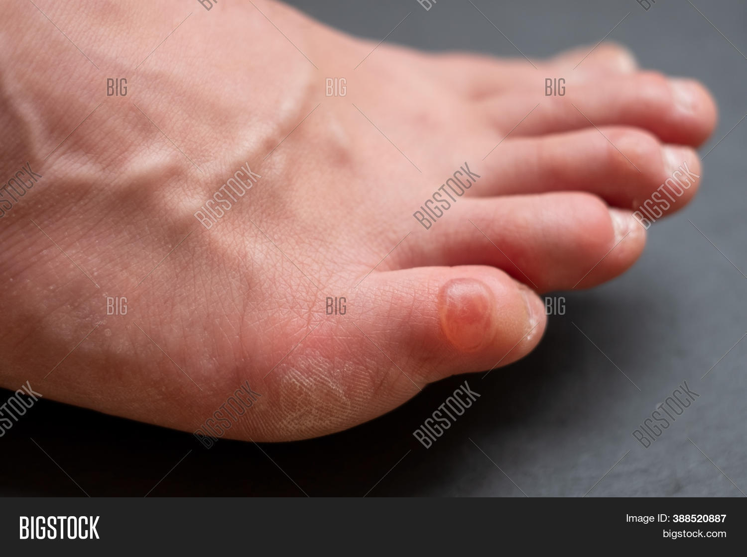 Callus On Pinky Toe Image & Photo (Free Trial) | Bigstock