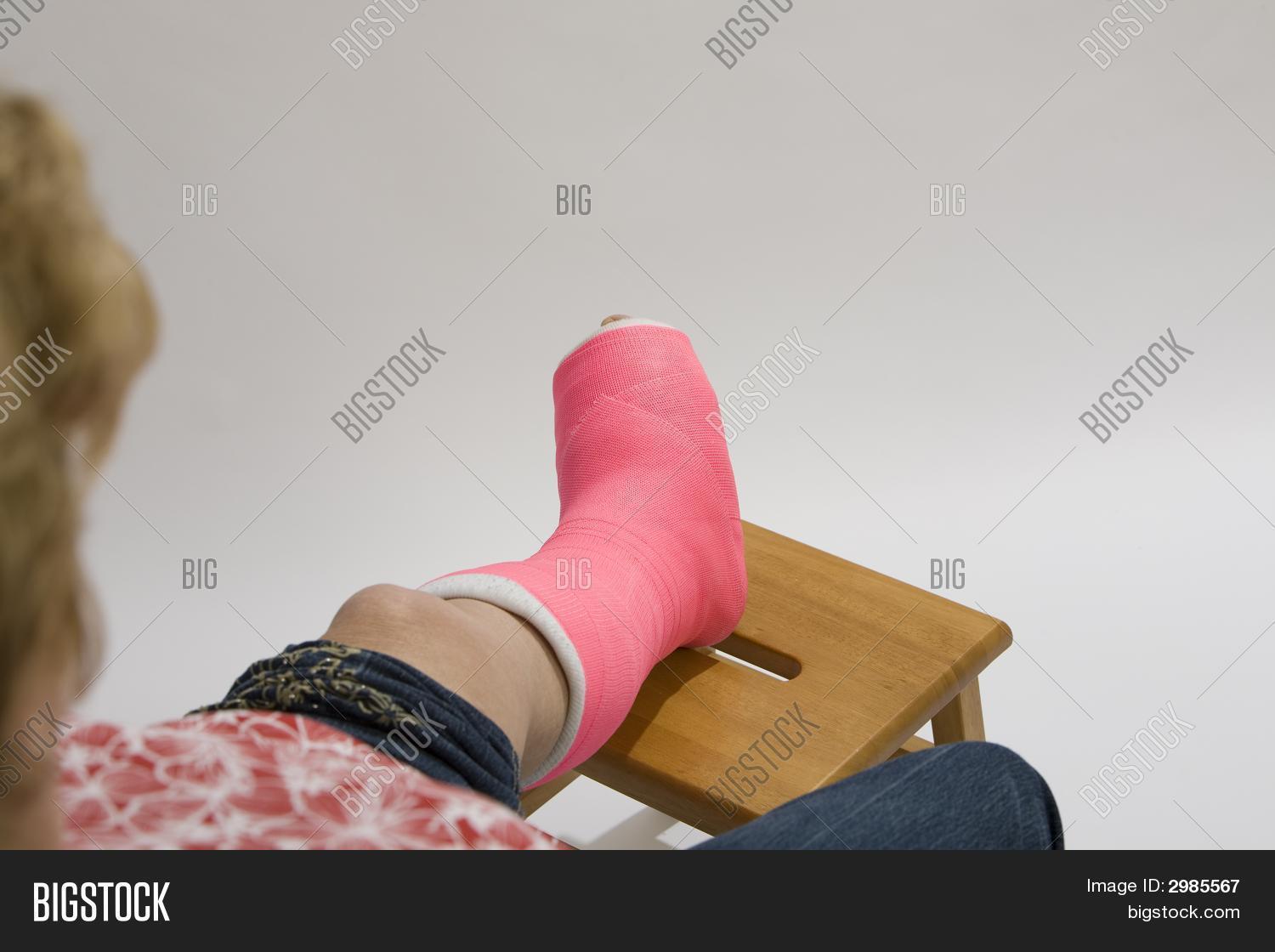 Woman Foot Cast Image & Photo (Free Trial) | Bigstock