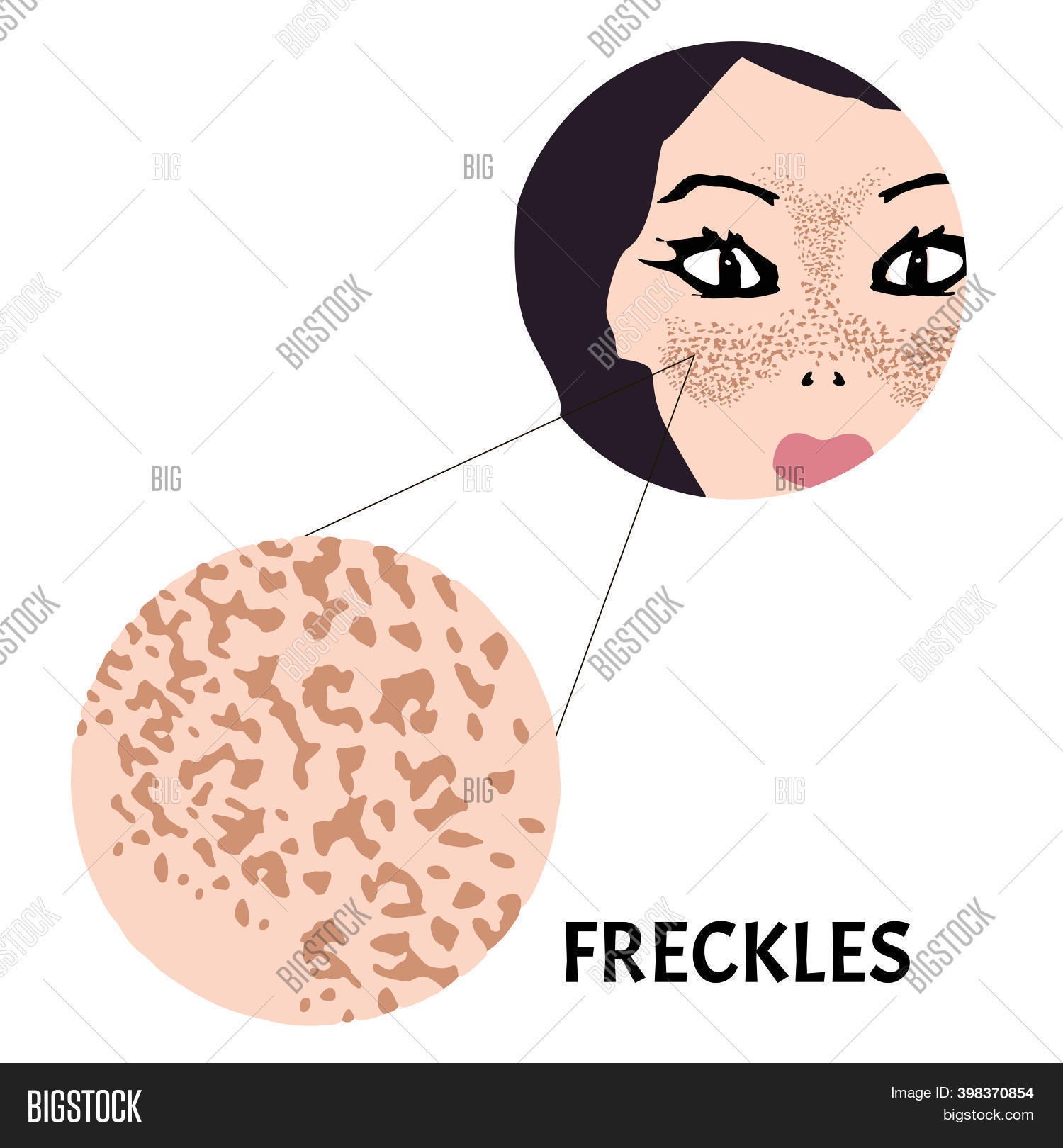Freckles On Face. Image & Photo (Free Trial) | Bigstock