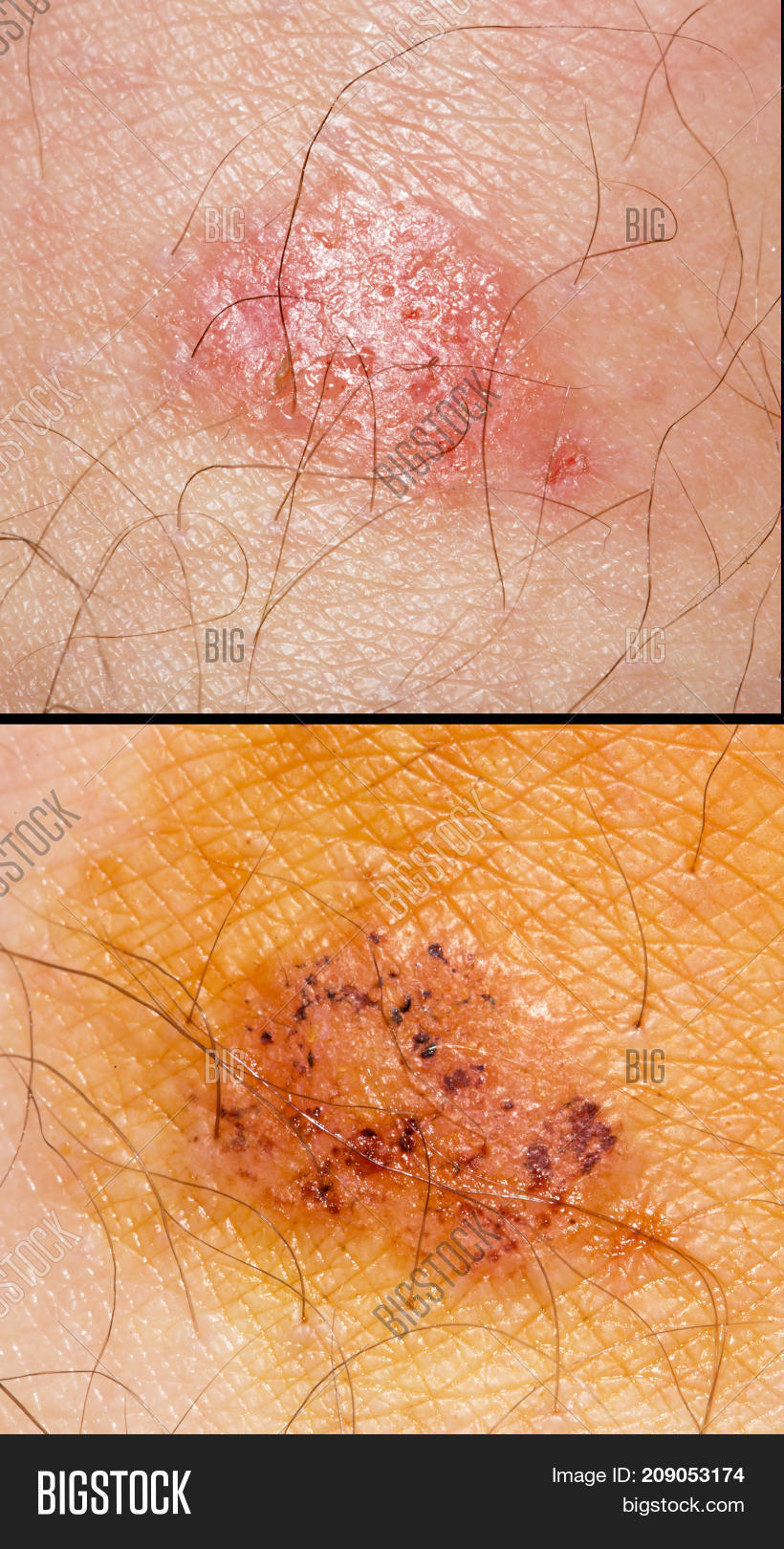 Ringworm Skin. Macro Image & Photo (Free Trial) | Bigstock