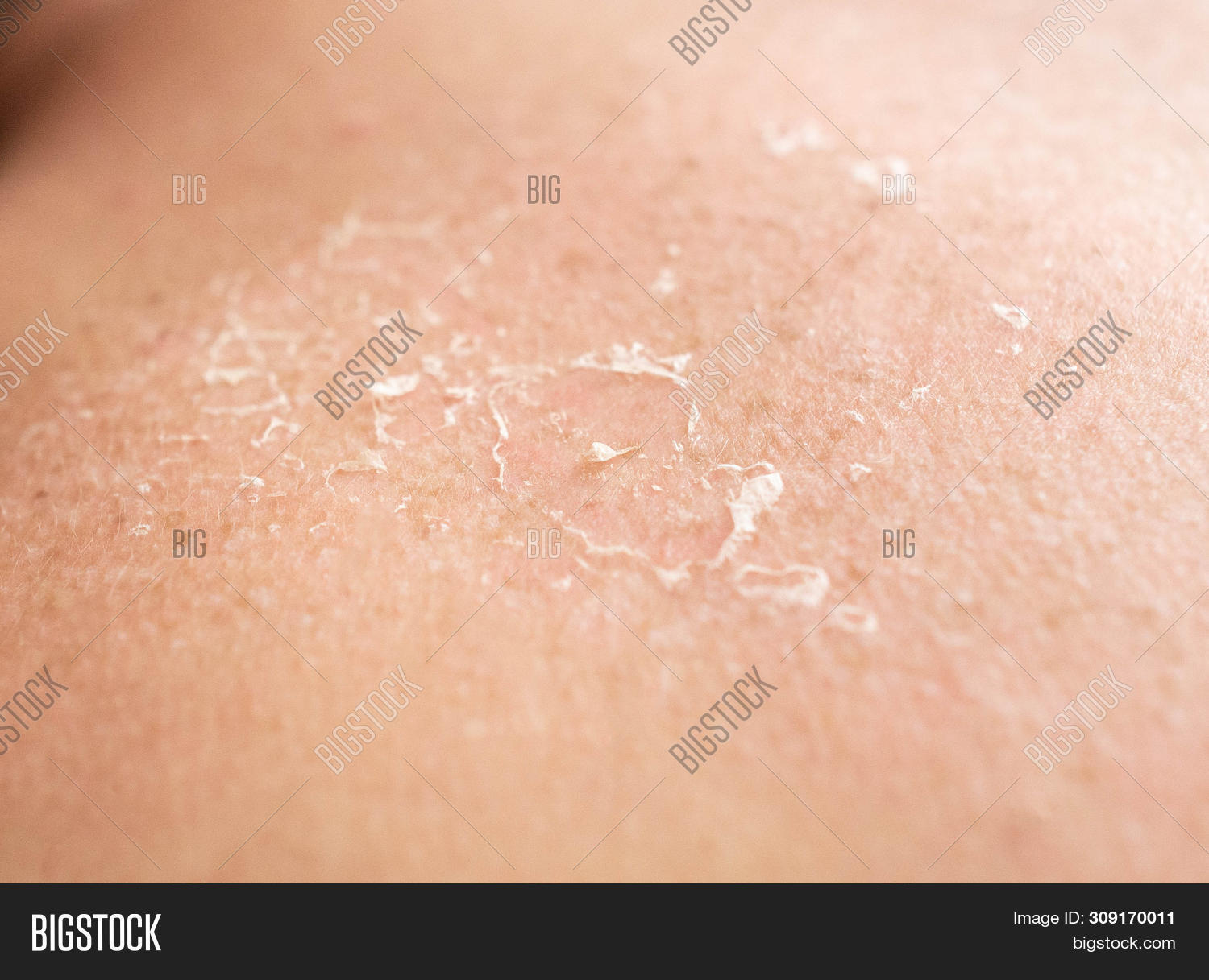 Flaking Skin After Image & Photo (Free Trial) | Bigstock