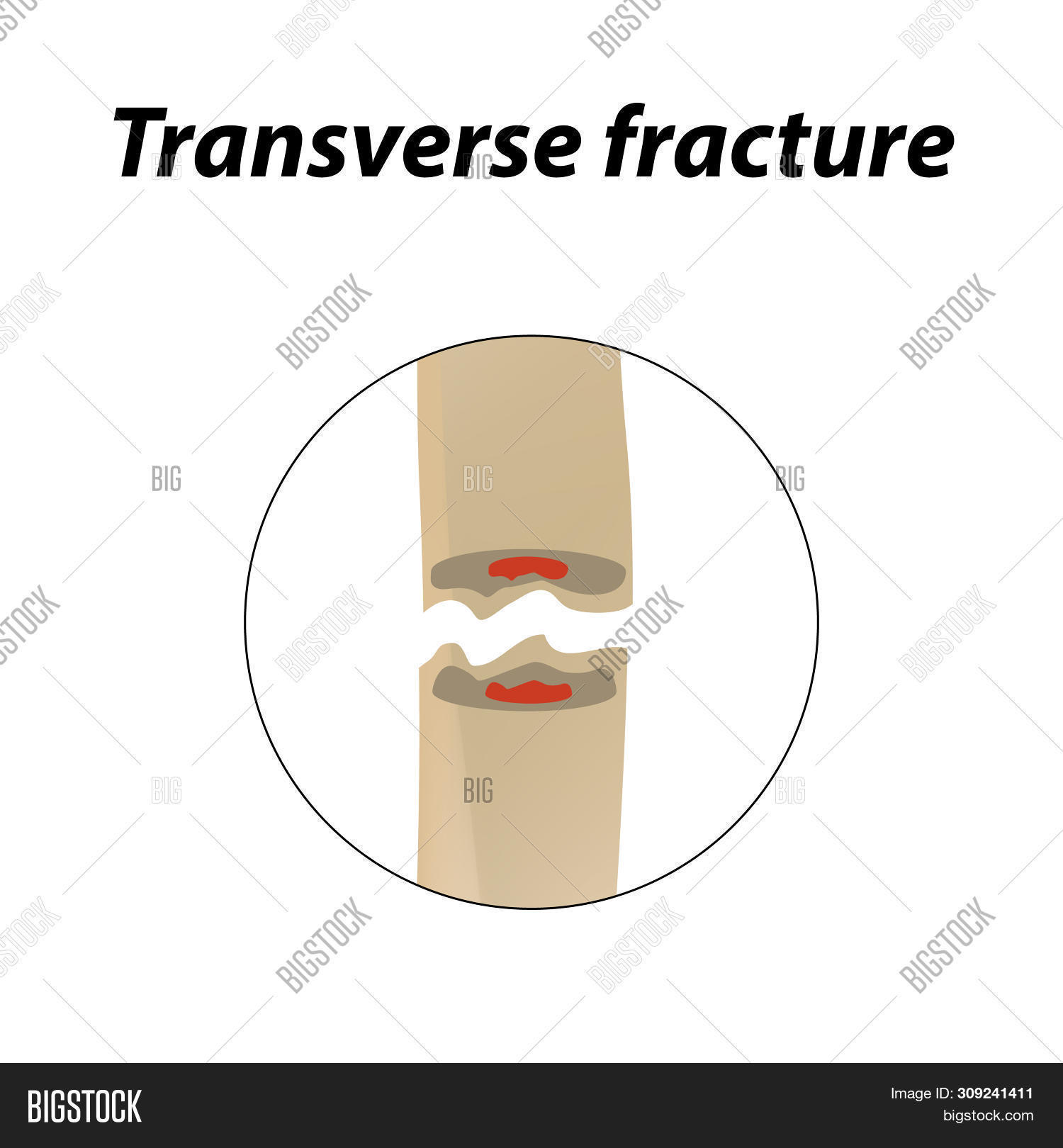 Transverse Bone Image & Photo (Free Trial) | Bigstock