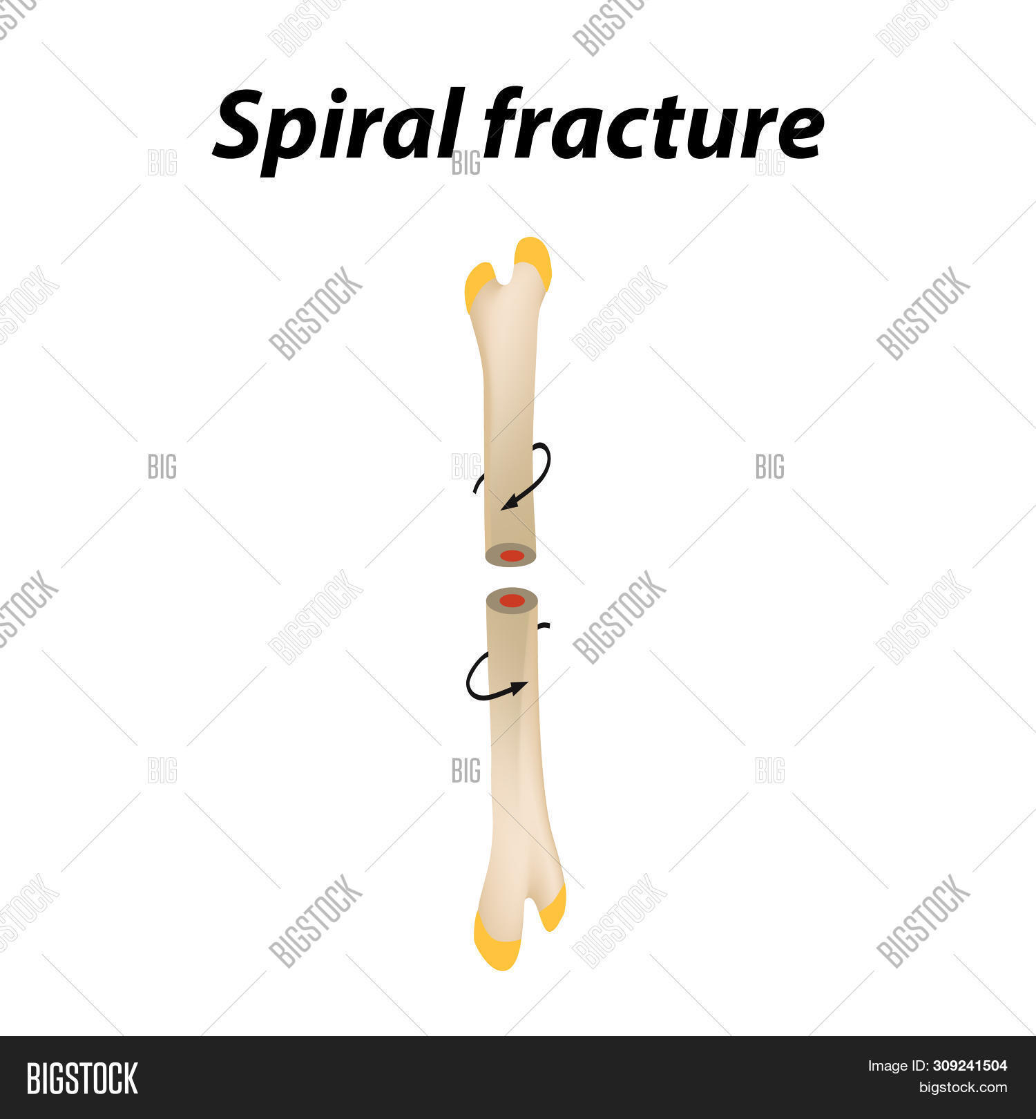 Spiral Bone Fracture. Image & Photo (Free Trial) | Bigstock